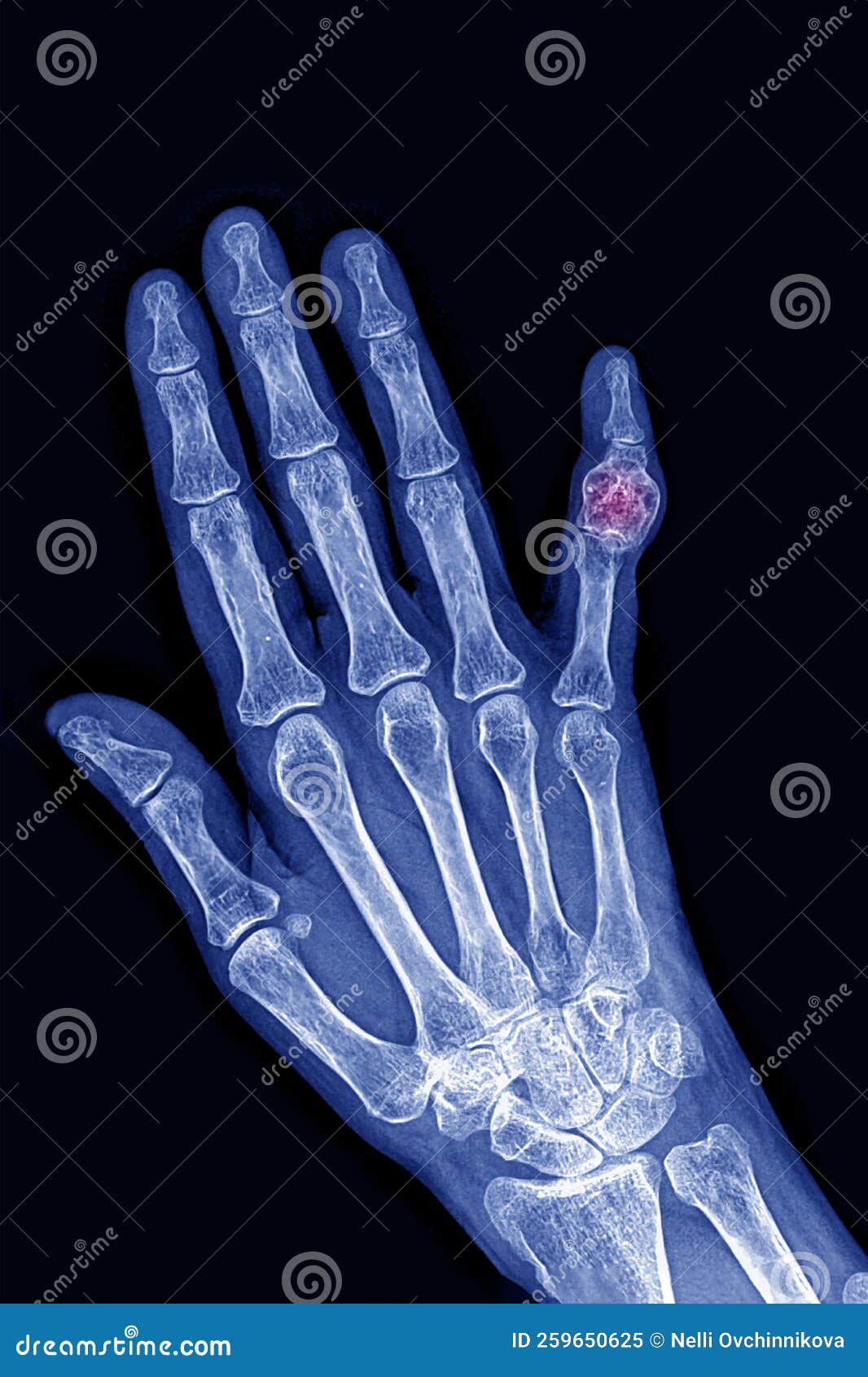 Neoplastic Process of the Middle Third of the V Finger Stock Image ...