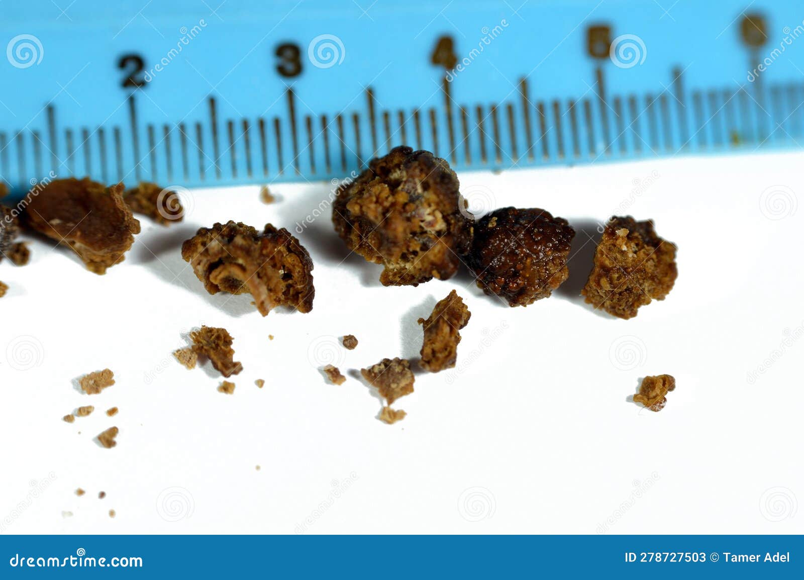 Nephrolithiasis, Irregular Brown Kidney Stones (renal Calculus or ... Nephrolithiasis, Irregular Brown Kidney Stones (renal Calculus or ...