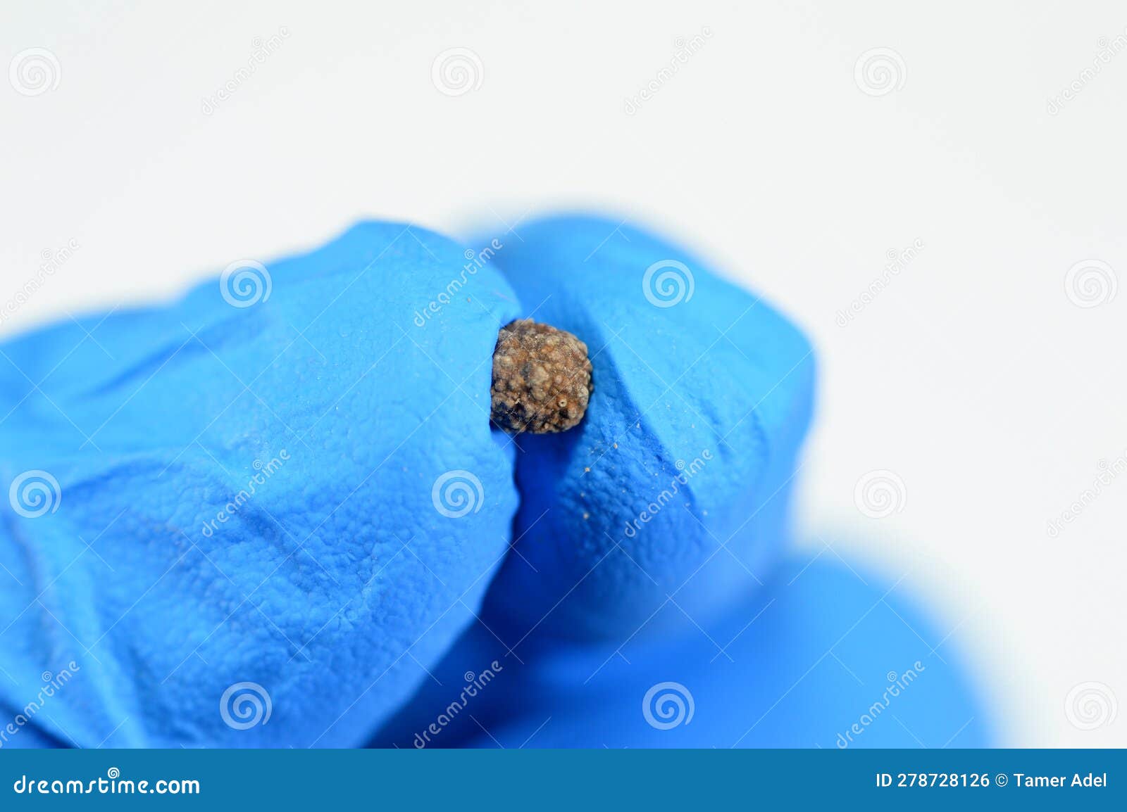 Nephrolithiasis, Irregular Brown Kidney Stones (renal Calculus or ...