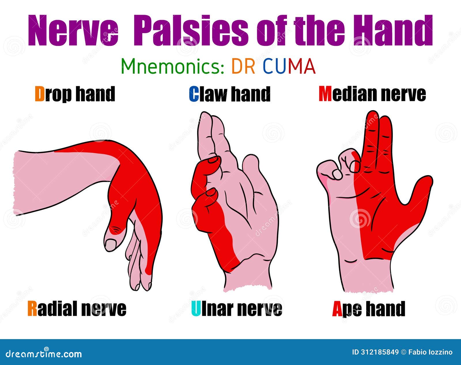Nerve Palsies of the Hand. Illustration for Students and Doctors Stock ...