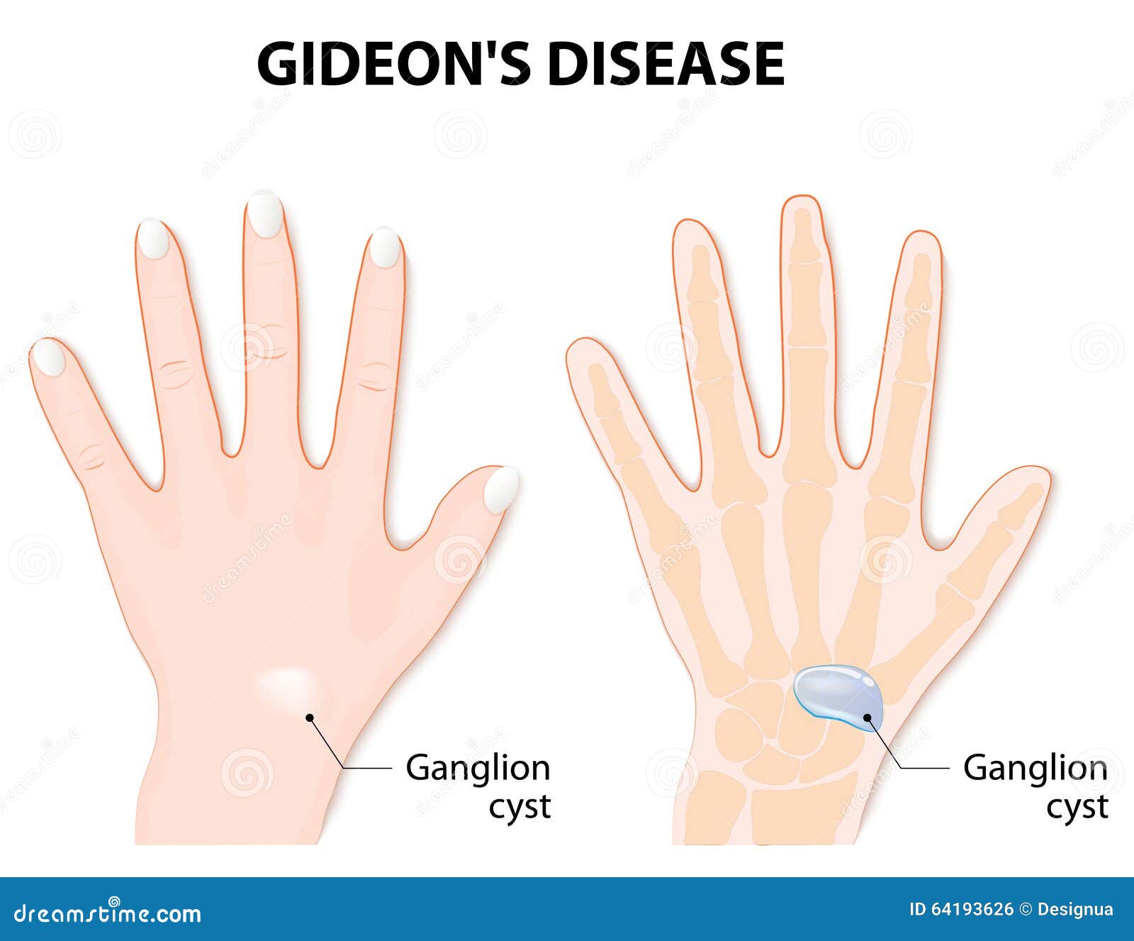 Nervknutcysta Eller Synovial Cysta Vektor Illustrationer - Illustration ...