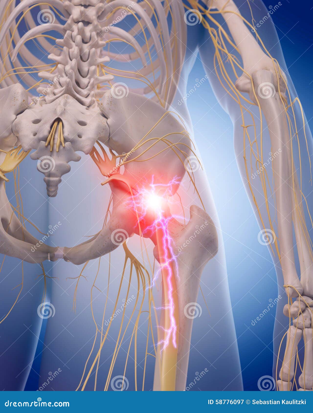 Nervo sciatico doloroso illustrazione di stock. Illustrazione di ...