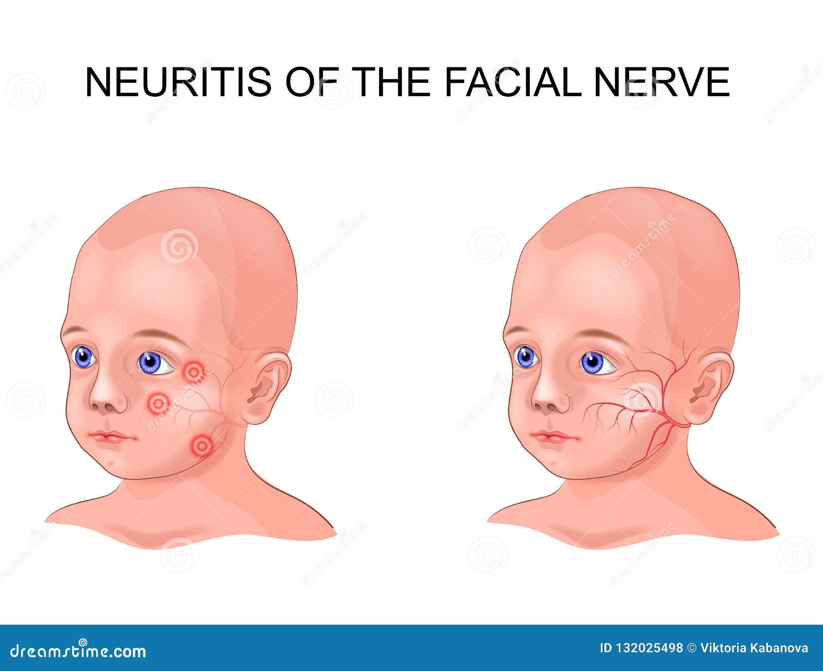 Nervus Facialis-Neuritis in Einem Kind Vektor Abbildung - Illustration ...