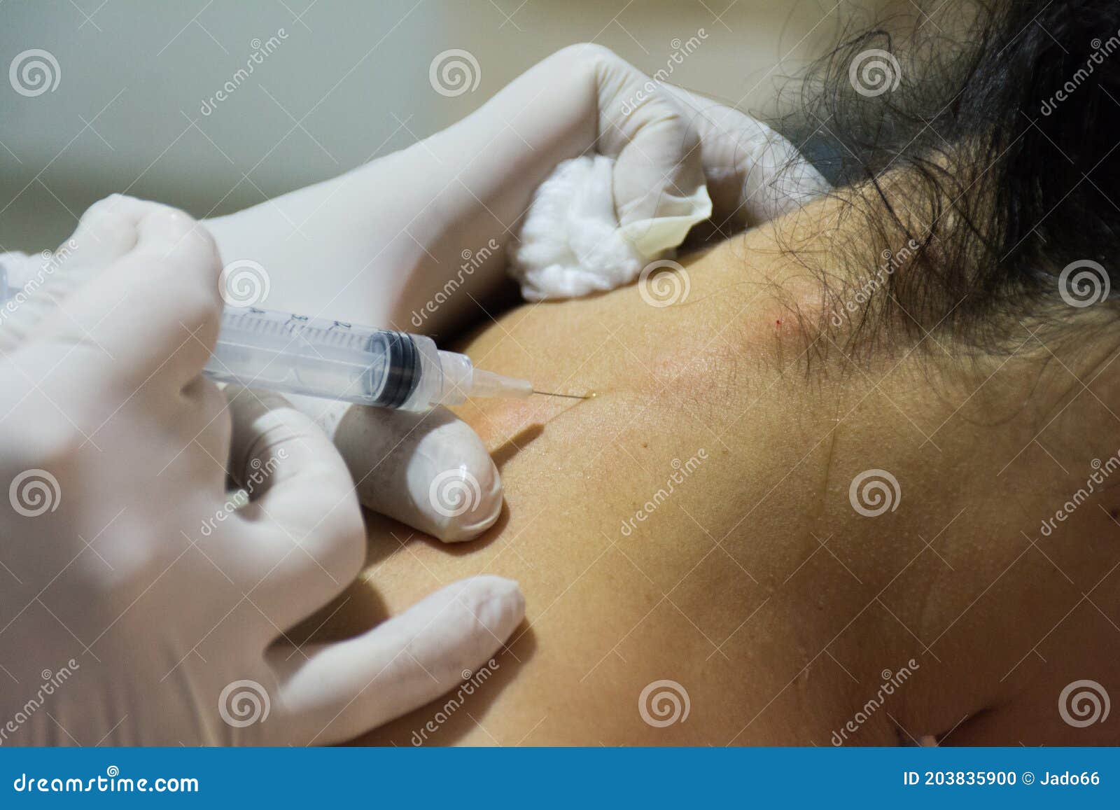 Neural Therapy Injection in Neck Stock Photo - Image of joint ...