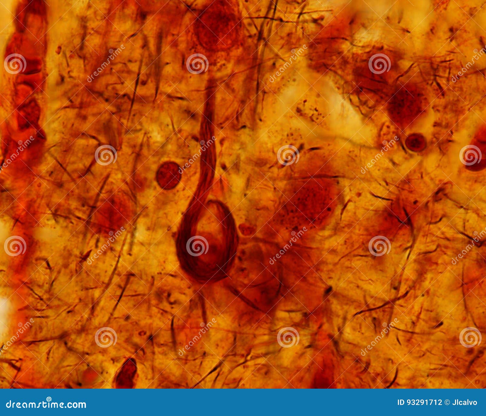 Neurofibrillary Tangle. Alzheimer Disease Stock Photo - Image of ...