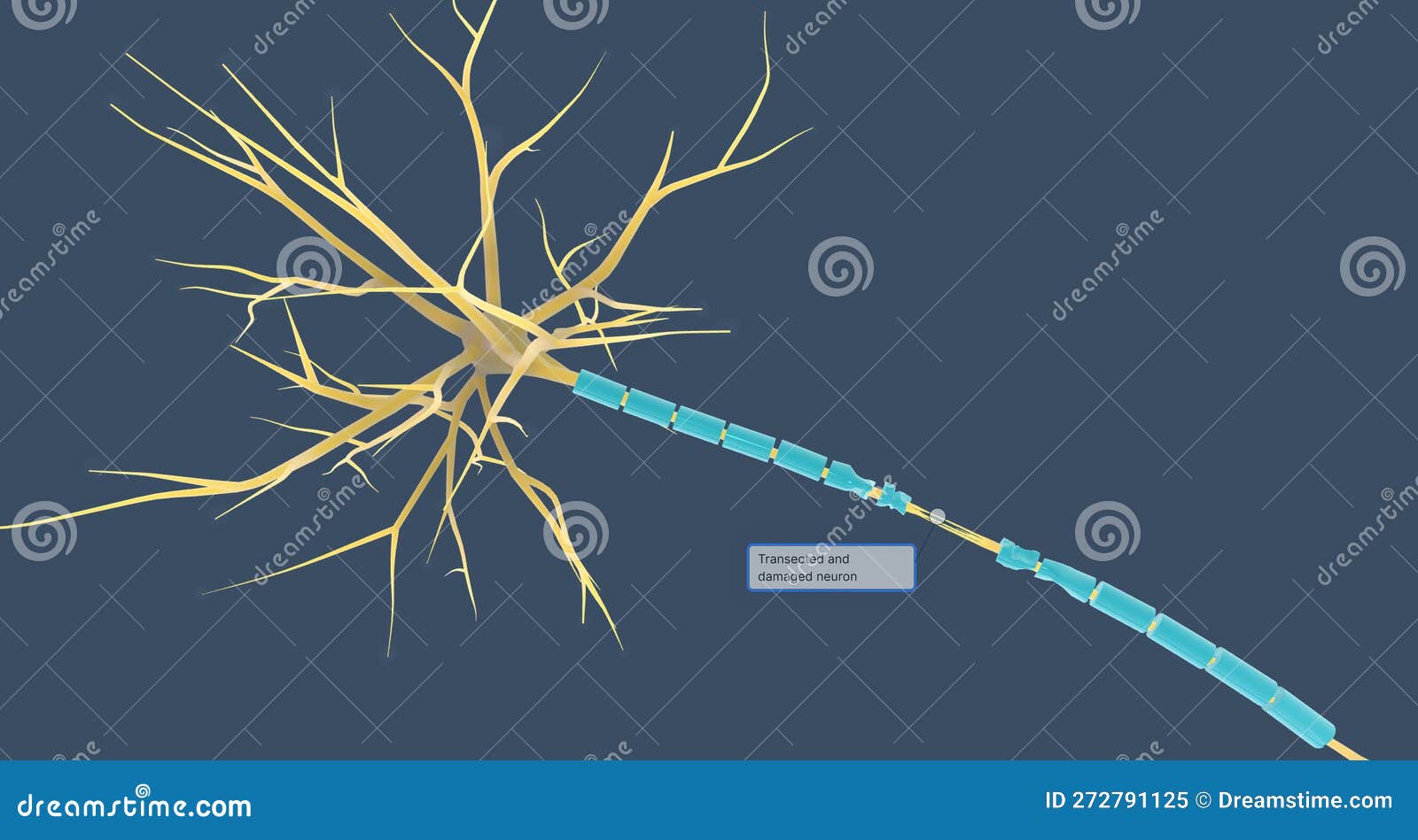 The Neuron Damage in Concussion Stock Illustration - Illustration of ...