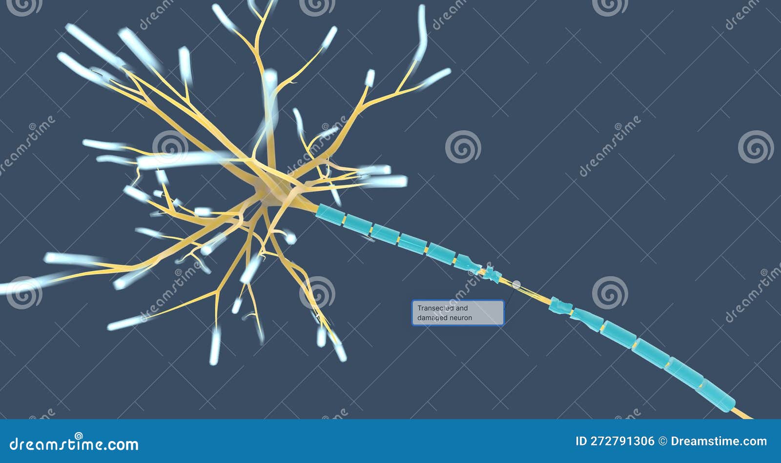 The Neuron Damage in Concussion Stock Illustration - Illustration of ...