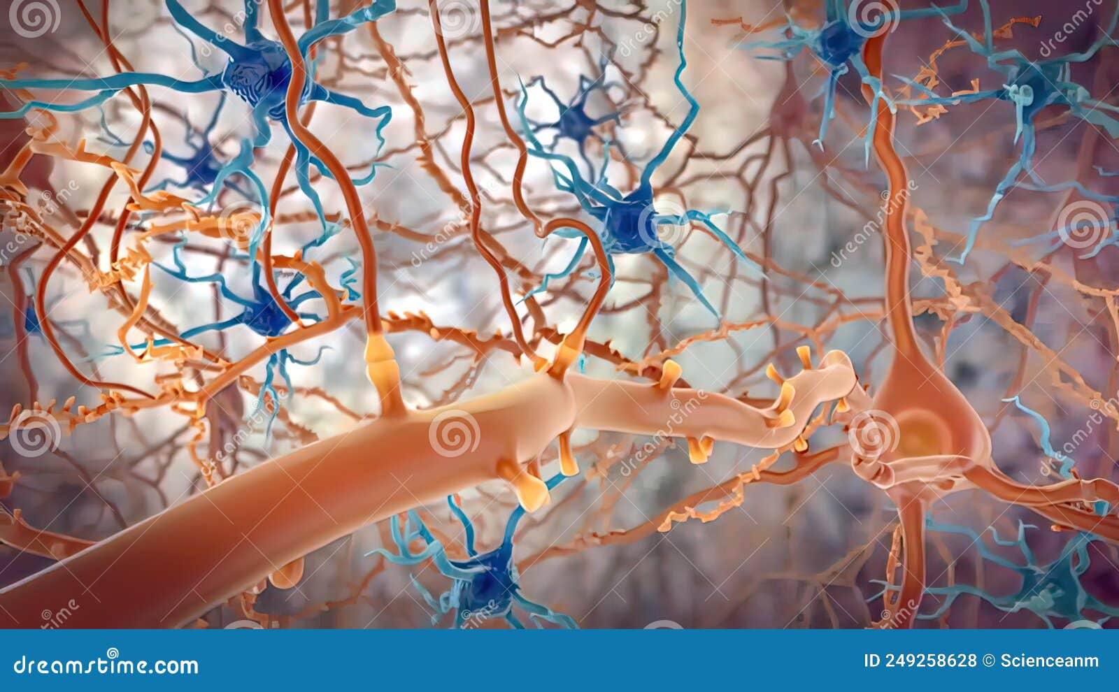 Neurons with Amyloid Plaques Stock Illustration - Illustration of ...