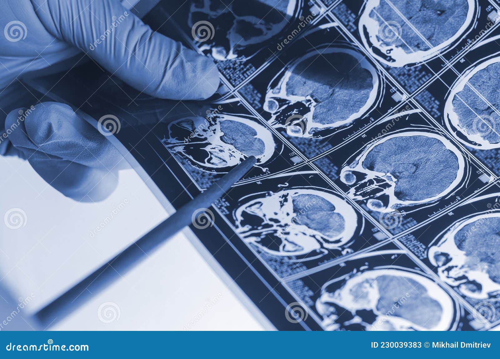 Neurosurgeon Shows the Point of an X-ray of the Human Brain with Stock ...