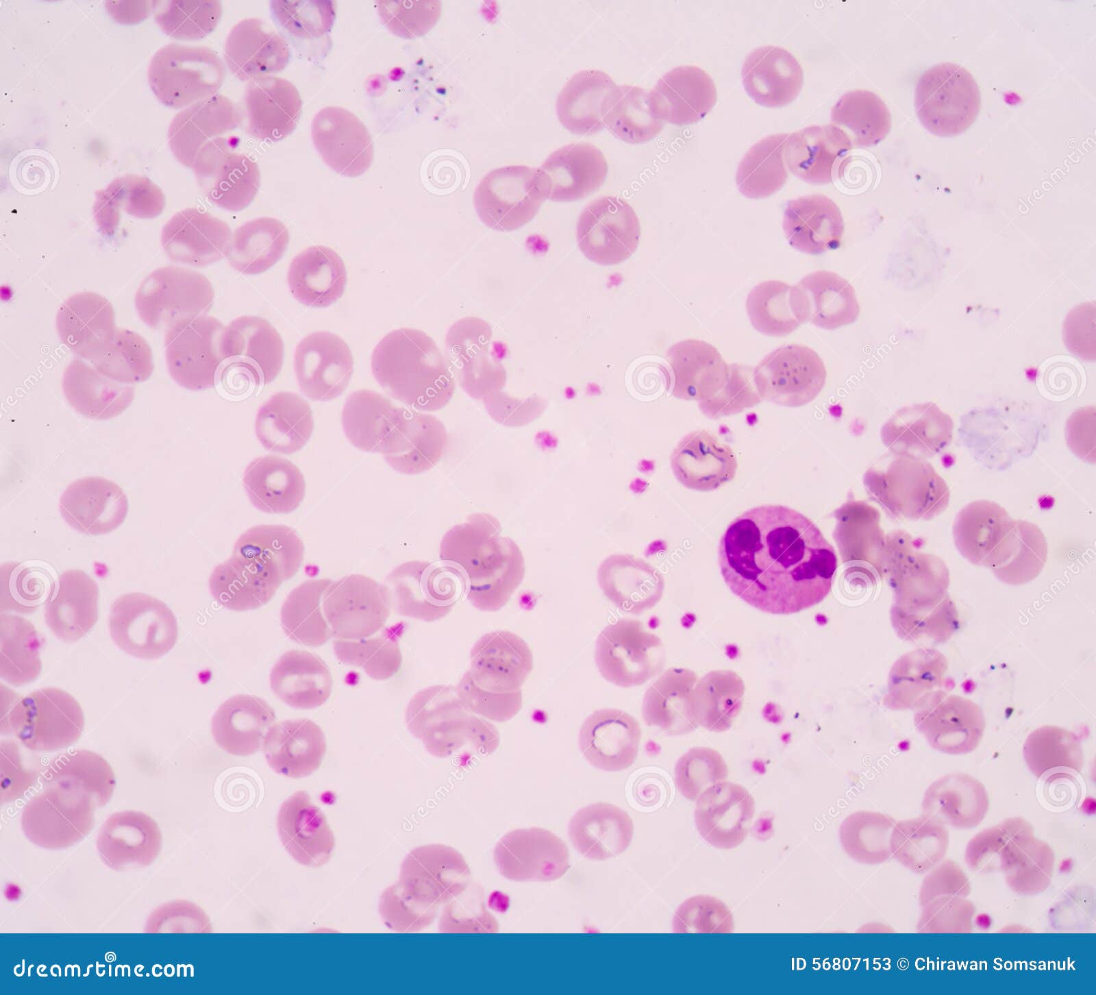 Neutrófilo De Hypersegmented Imagem de Stock - Imagem de vascular ...