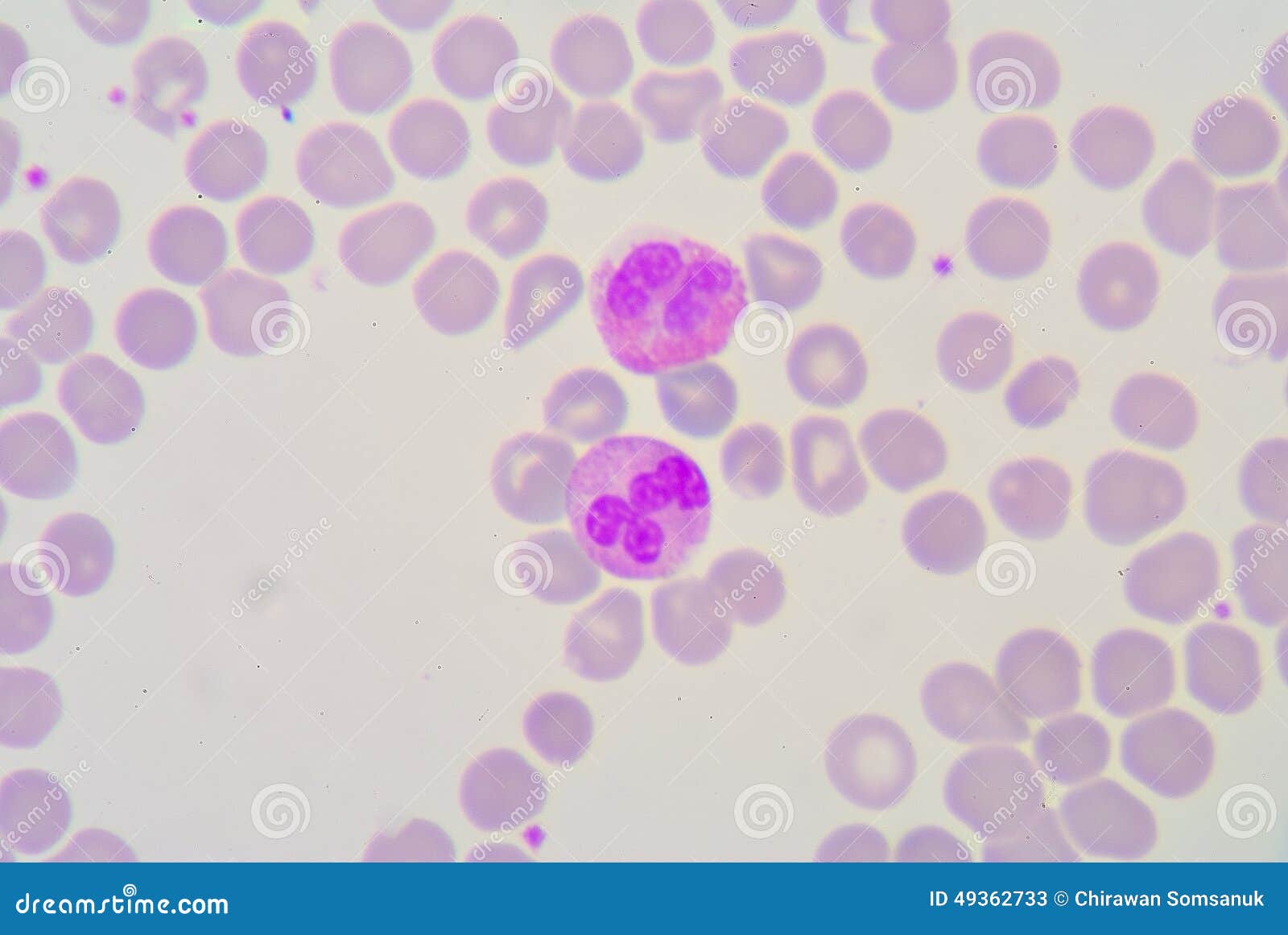 Neutrofili segmentati immagine stock. Immagine di malattia - 49362733