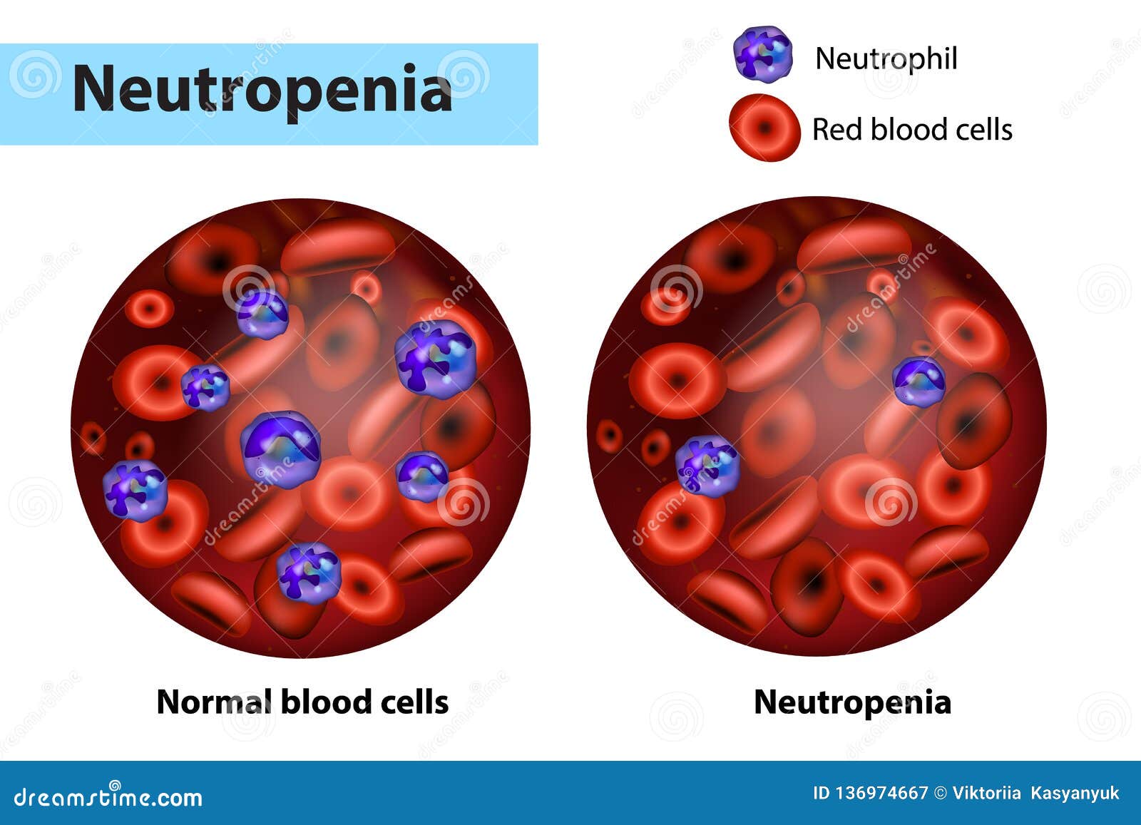 Neutropenia Eller Neutropaenia Vektor Illustrationer - Illustration av ...