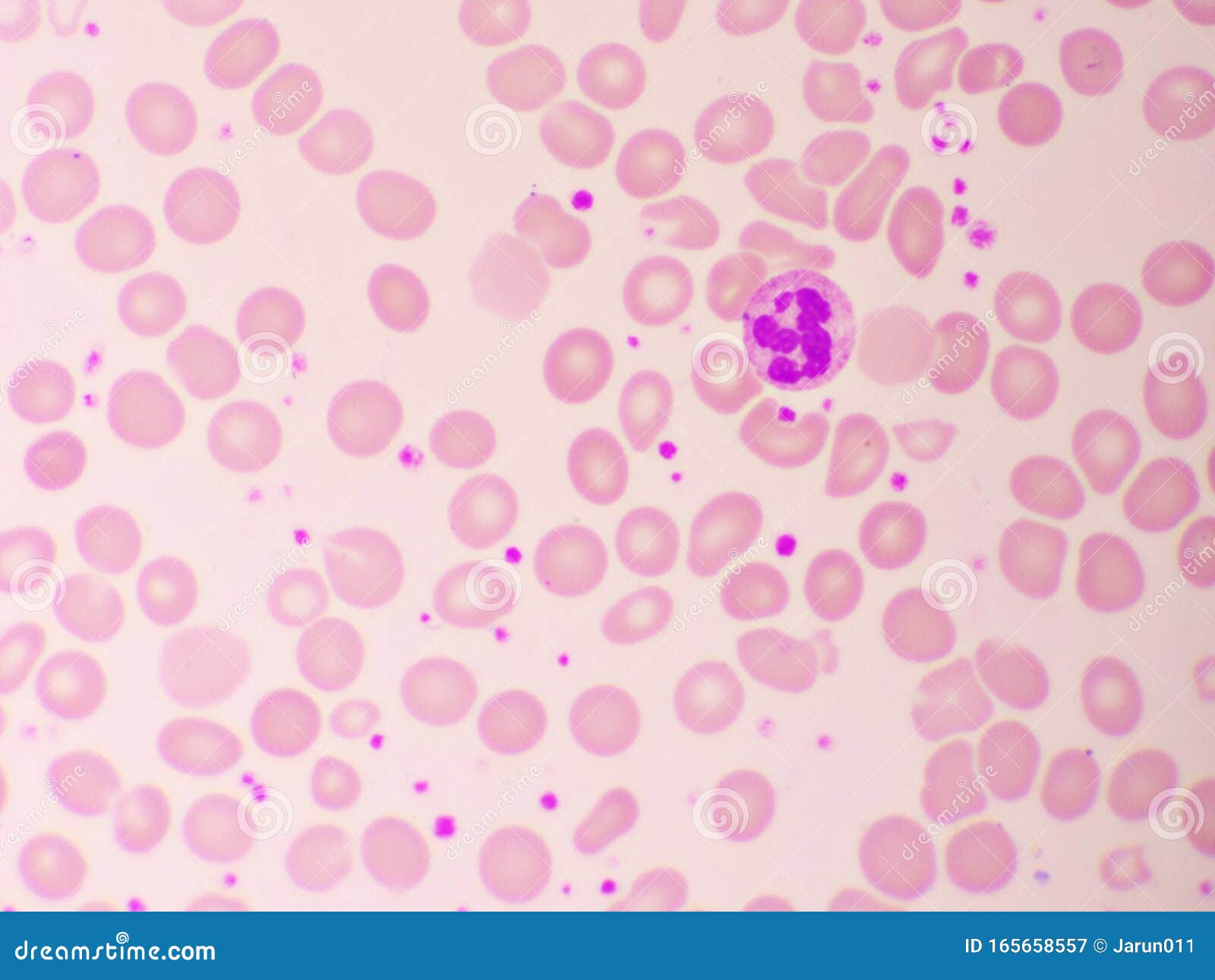 Neutrophil Cell in Blood Smear Stock Image - Image of anemia ...