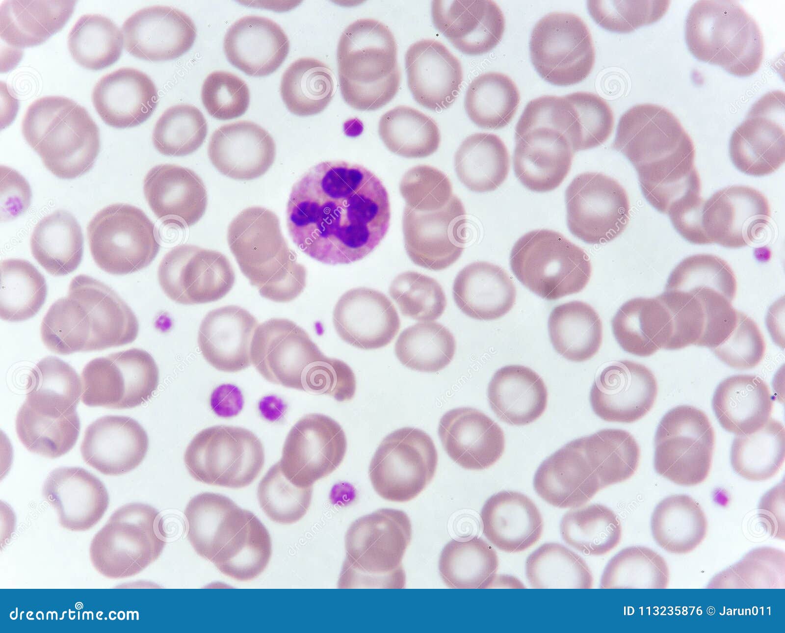 Neutrophil Cell in Blood Smear Stock Photo - Image of cells, disease ...