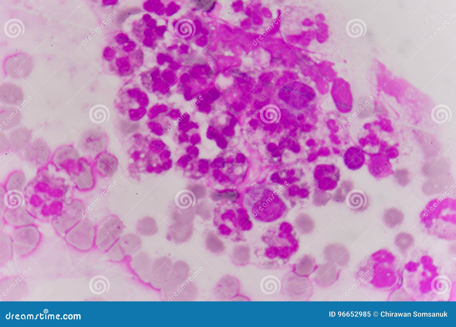 Neutrophil In Sepsis Patein Find With Microscope Royalty-Free Stock ...