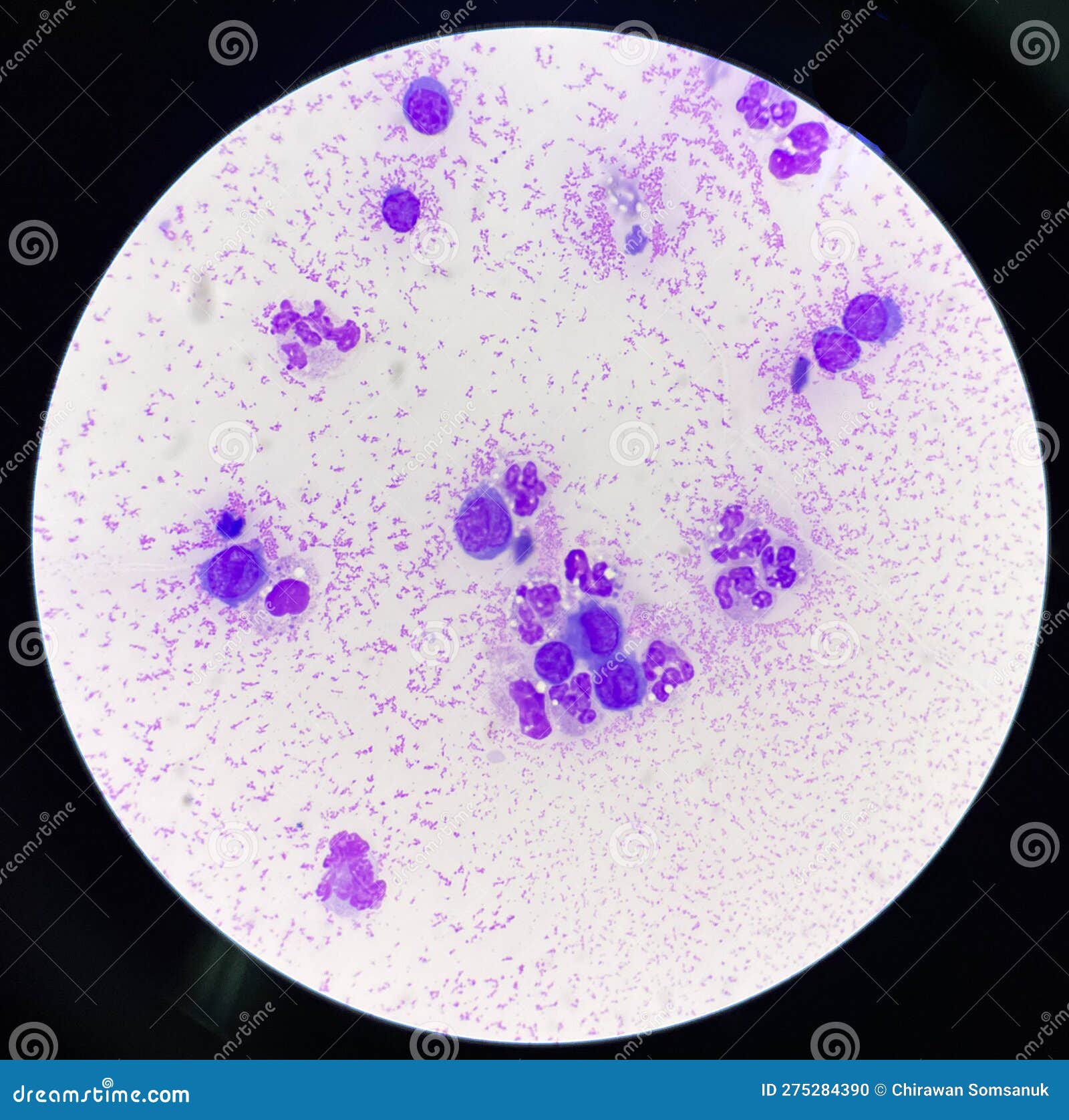 Neutrophil in Synovial Fluid Inframatory Cells Stock Photo - Image of ...