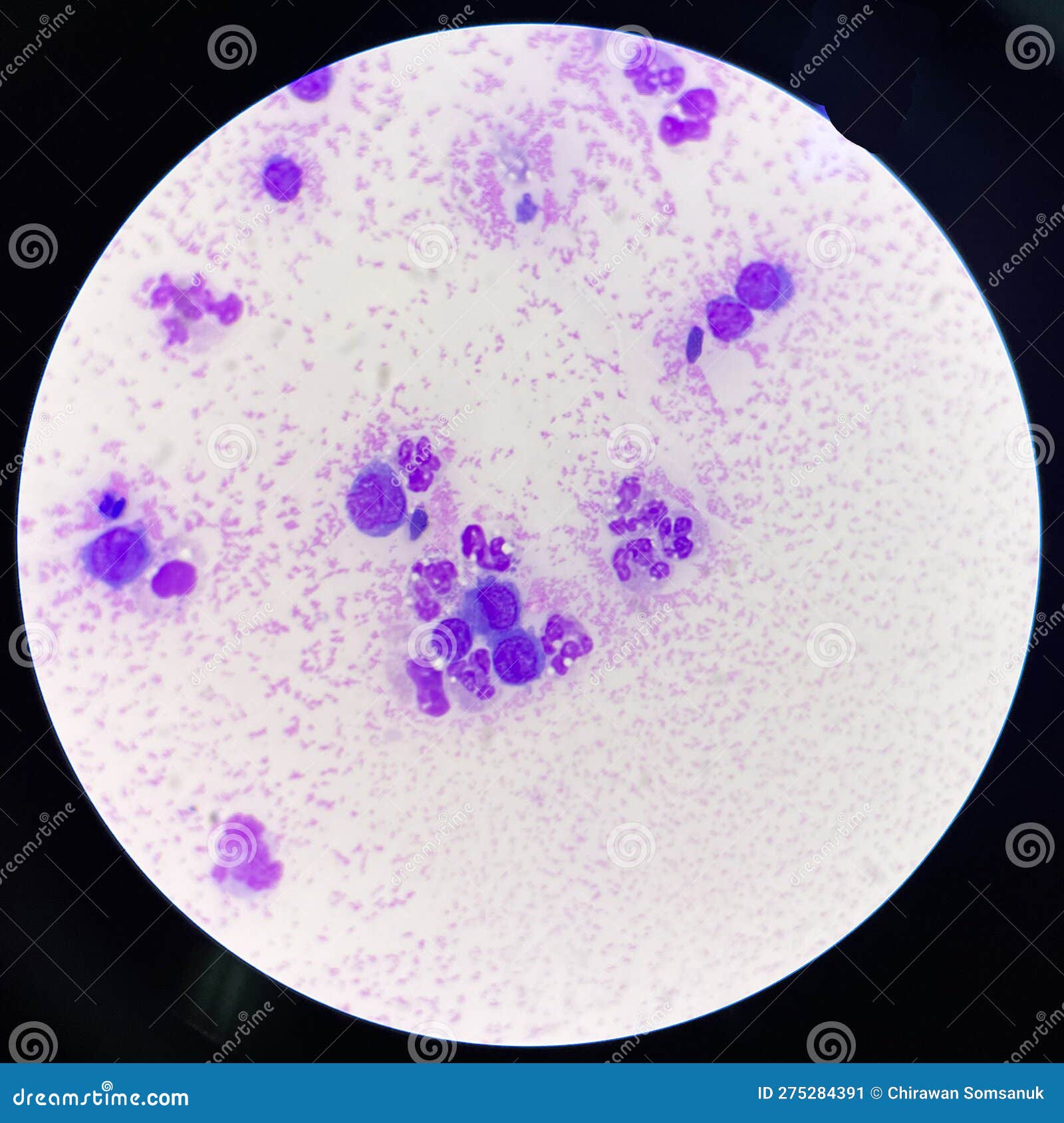 Neutrophil in Synovial Fluid Inframatory Cells Stock Image - Image of ...