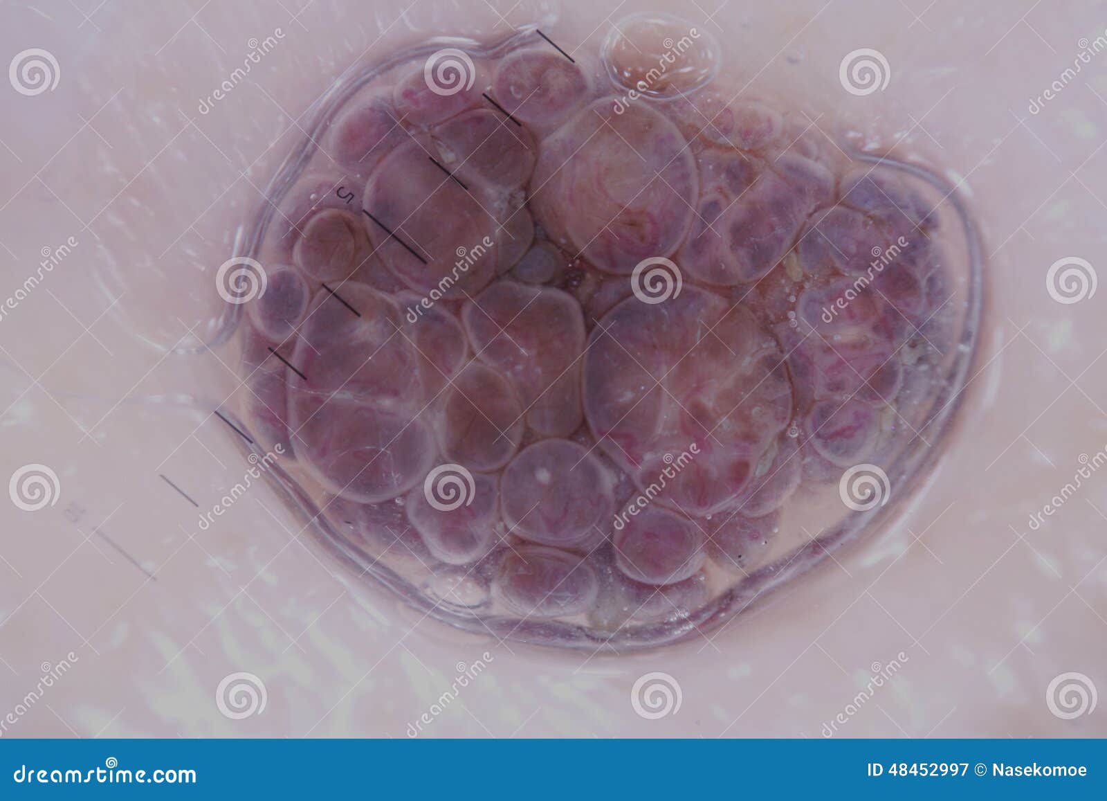 Nevus stock image. Image of tumor, dermatology, disease - 48452997