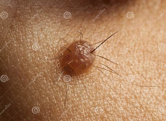 Nevus Hair stock photo. Image of benign, intradermal - 15755184