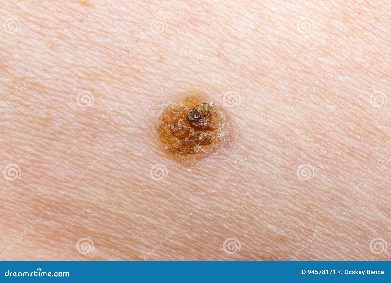 Nevus on human skin stock image. Image of epidermal, blemish - 94578171