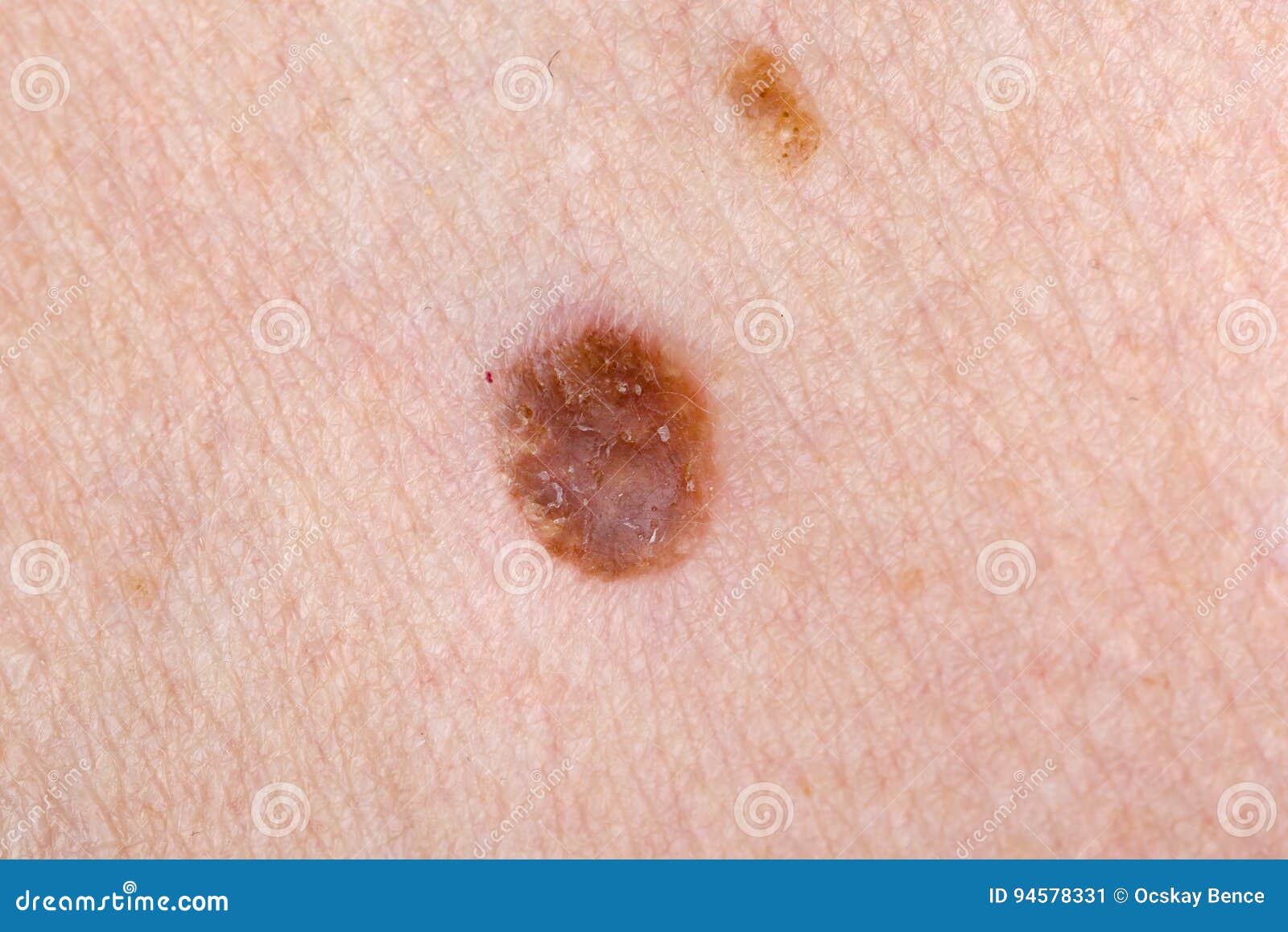 Nevus On Human Skin Royalty-Free Stock Photo | CartoonDealer.com #94578237