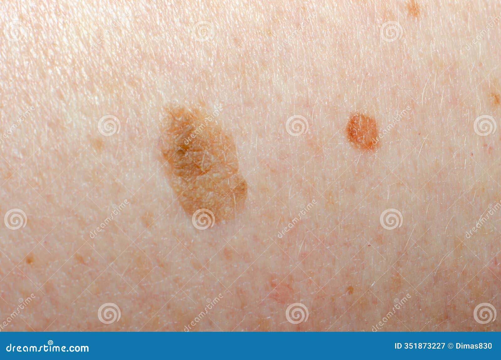 Basalioma Or Solar Keratosis On The Scalp Of An Adult Stock Photo ...