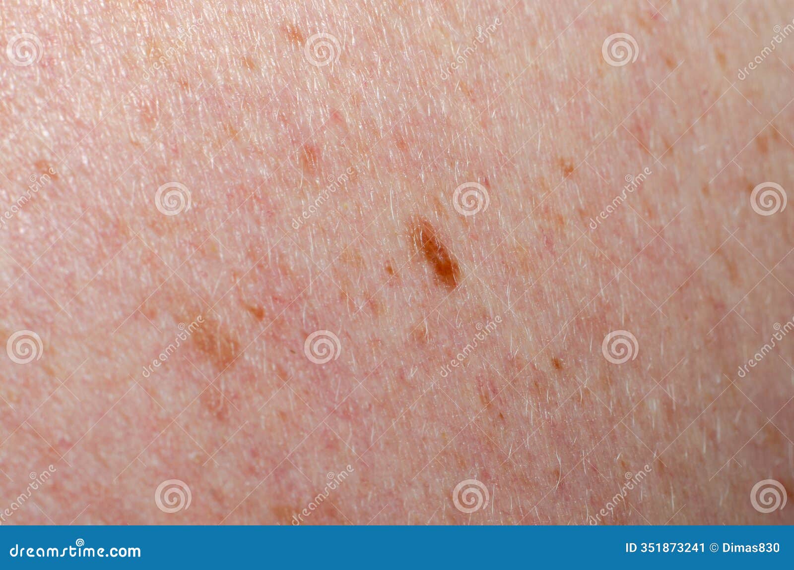 Basalioma Or Solar Keratosis On The Scalp Of An Adult Stock Photo ...