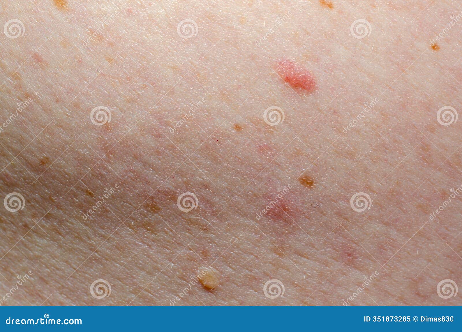 Basalioma Or Solar Keratosis On The Scalp Of An Adult Stock Photo ...