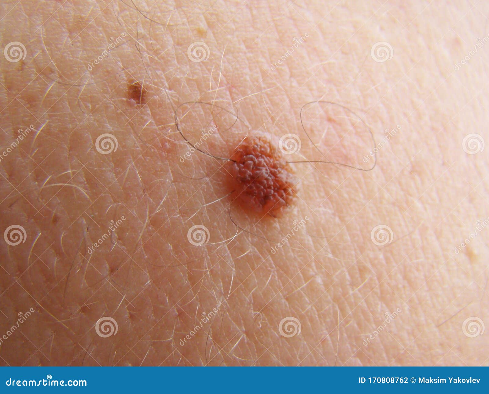 Nevus stock photo. Image of papilloma, medicine, large - 170808762