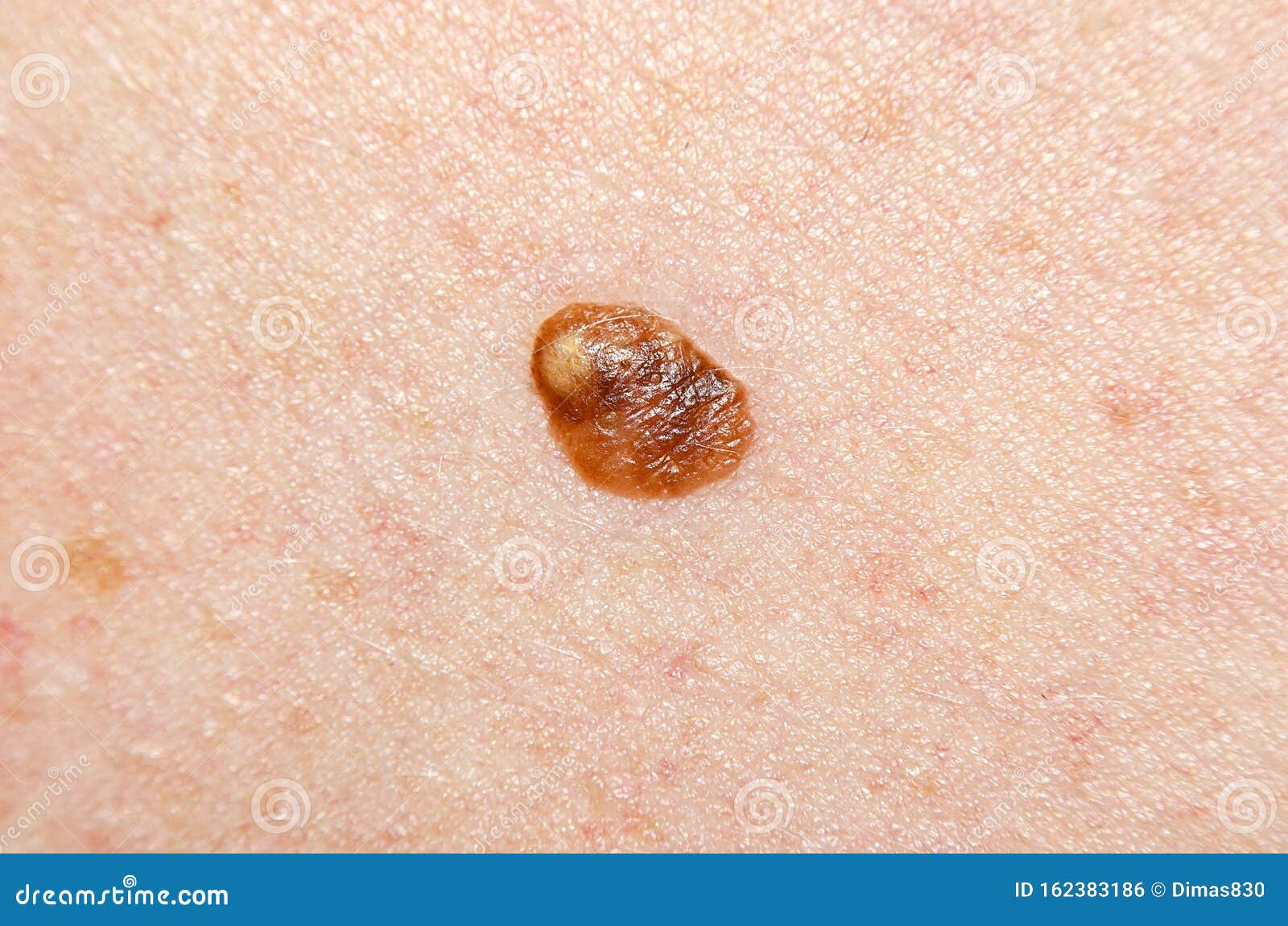 Nevus Or Mole On The Human Body Close Up Skin Cancer Keratosis Or