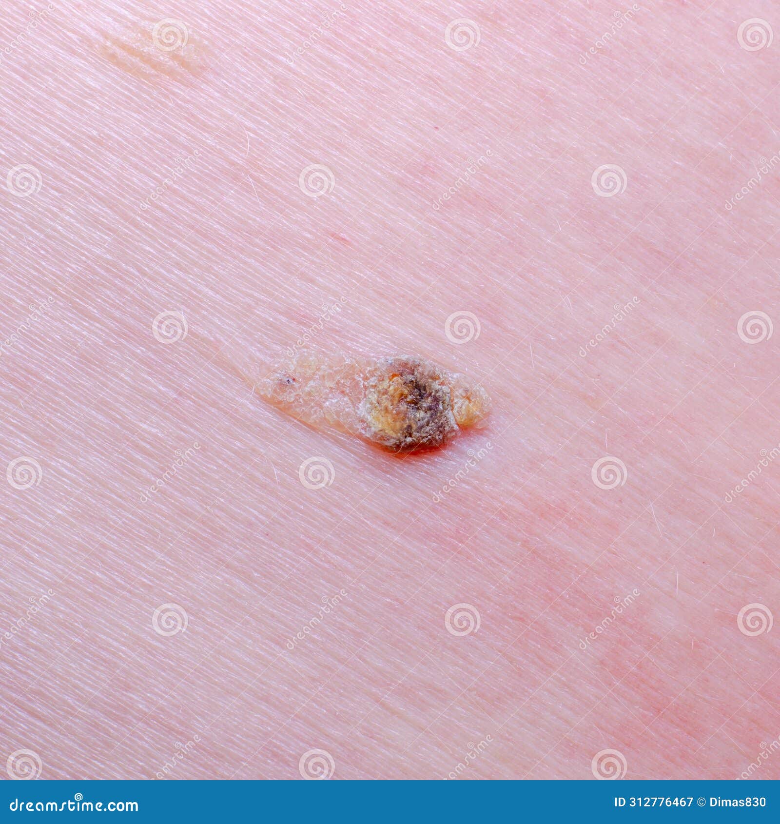 Nevus Or Mole On The Human Body Closeup. Skin Cancer, Keratosis Or ...