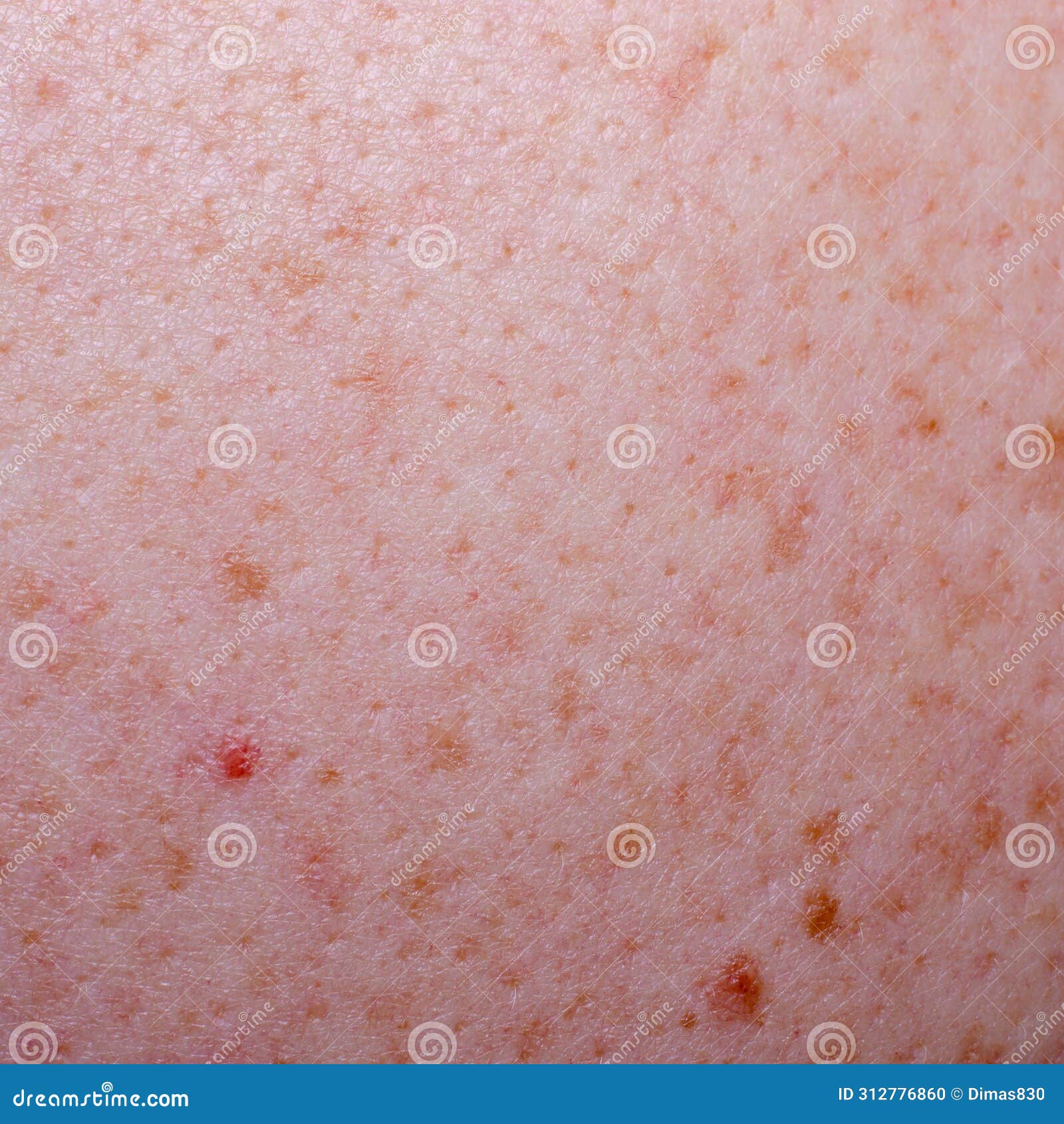 Nevus Or Mole On The Human Body Closeup. Skin Cancer, Keratosis Or ...