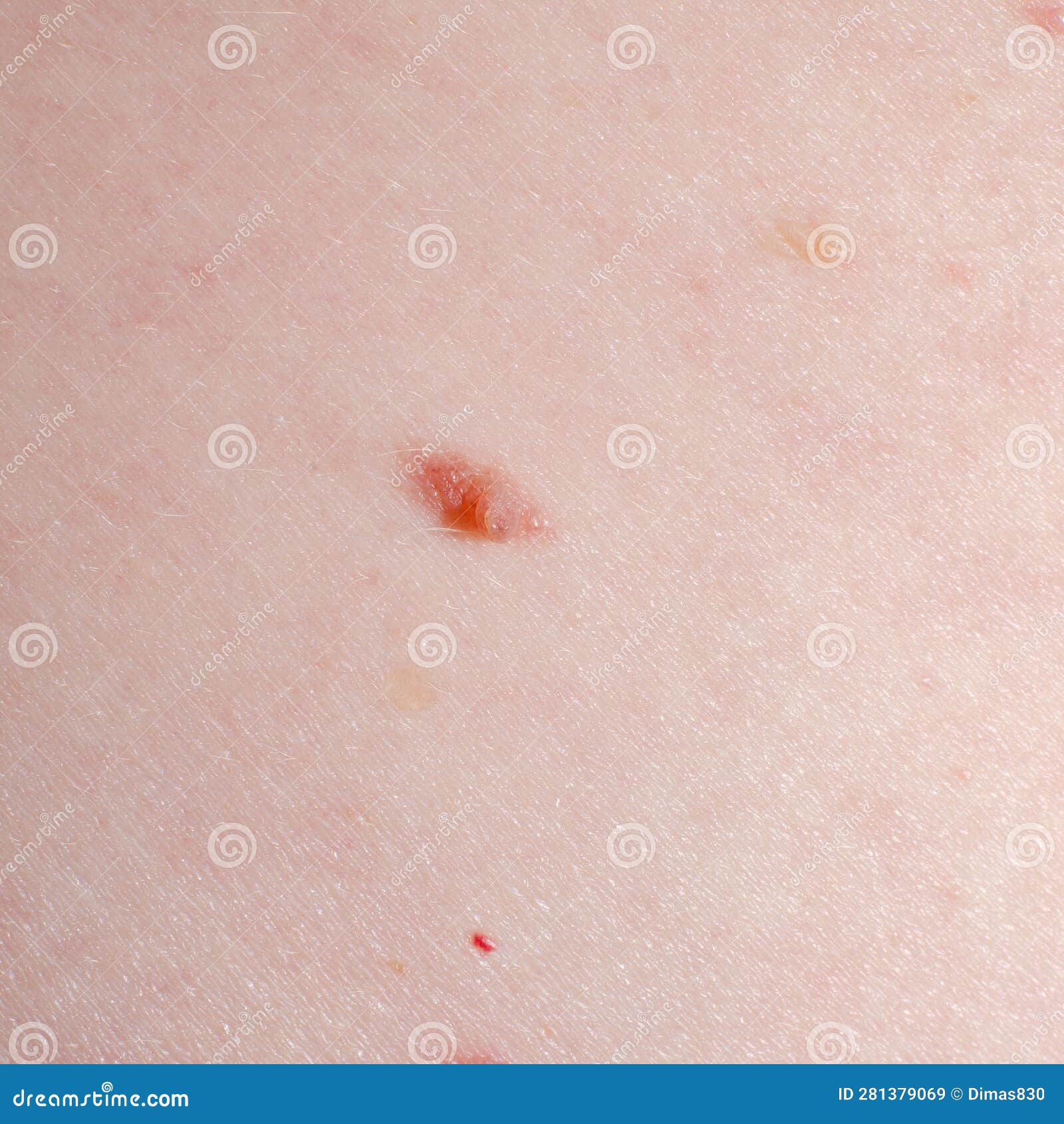 Nevus or Mole on the Skin of the Human Body Close-up Stock Image ...