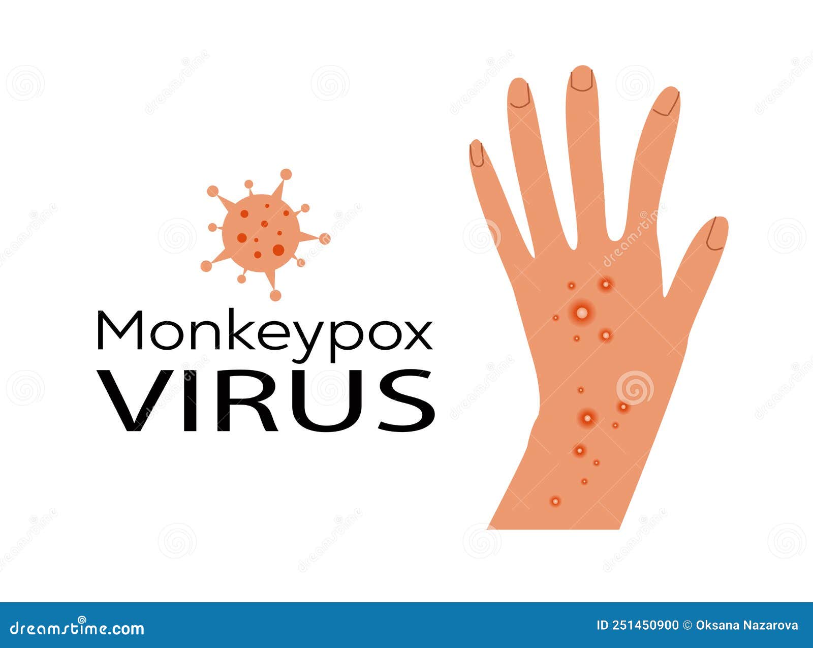 New Monkeypox Virus, Monkey Pox With Rashes On The Affected Arm Vector ...
