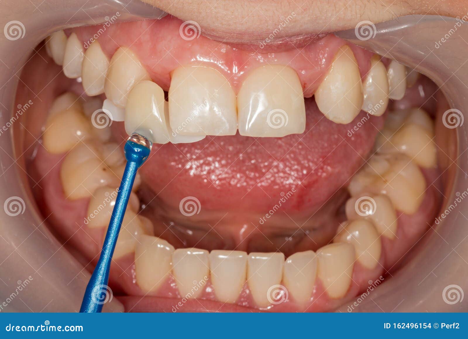 New teeth stock photo. Image of nick, color, mouth, number - 162496154