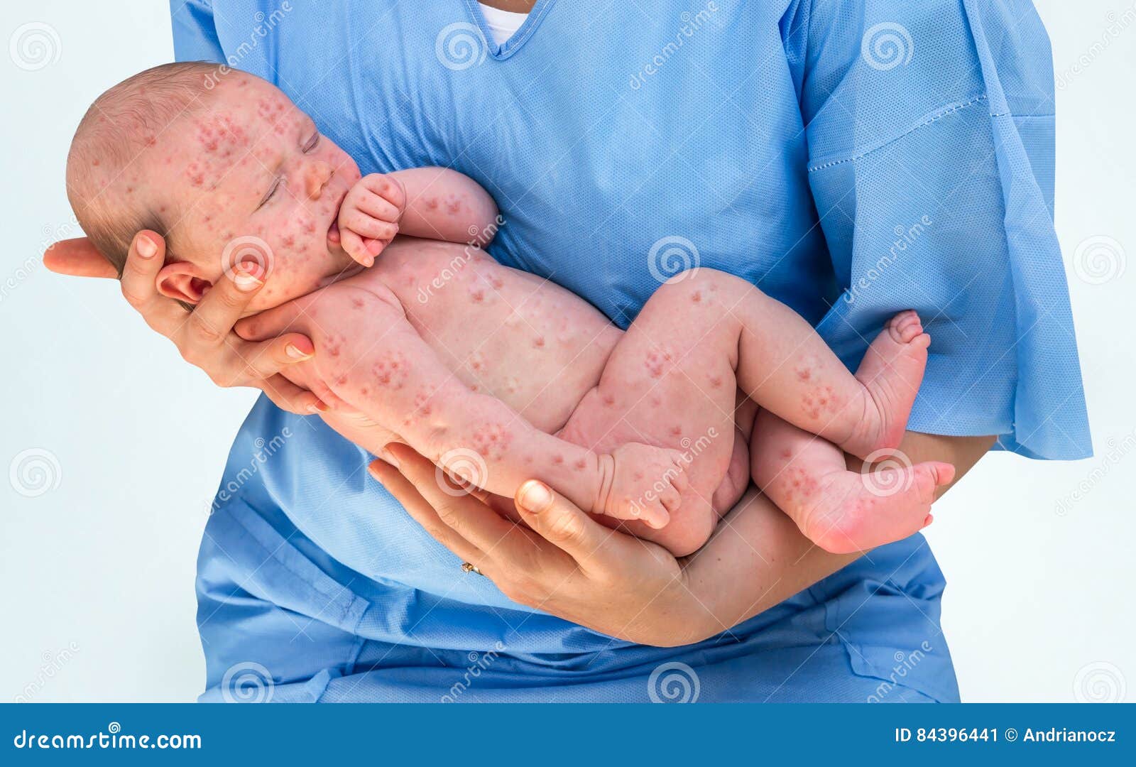 Newborn Baby with Chickenpox Stock Image - Image of hospital, neonatal ...