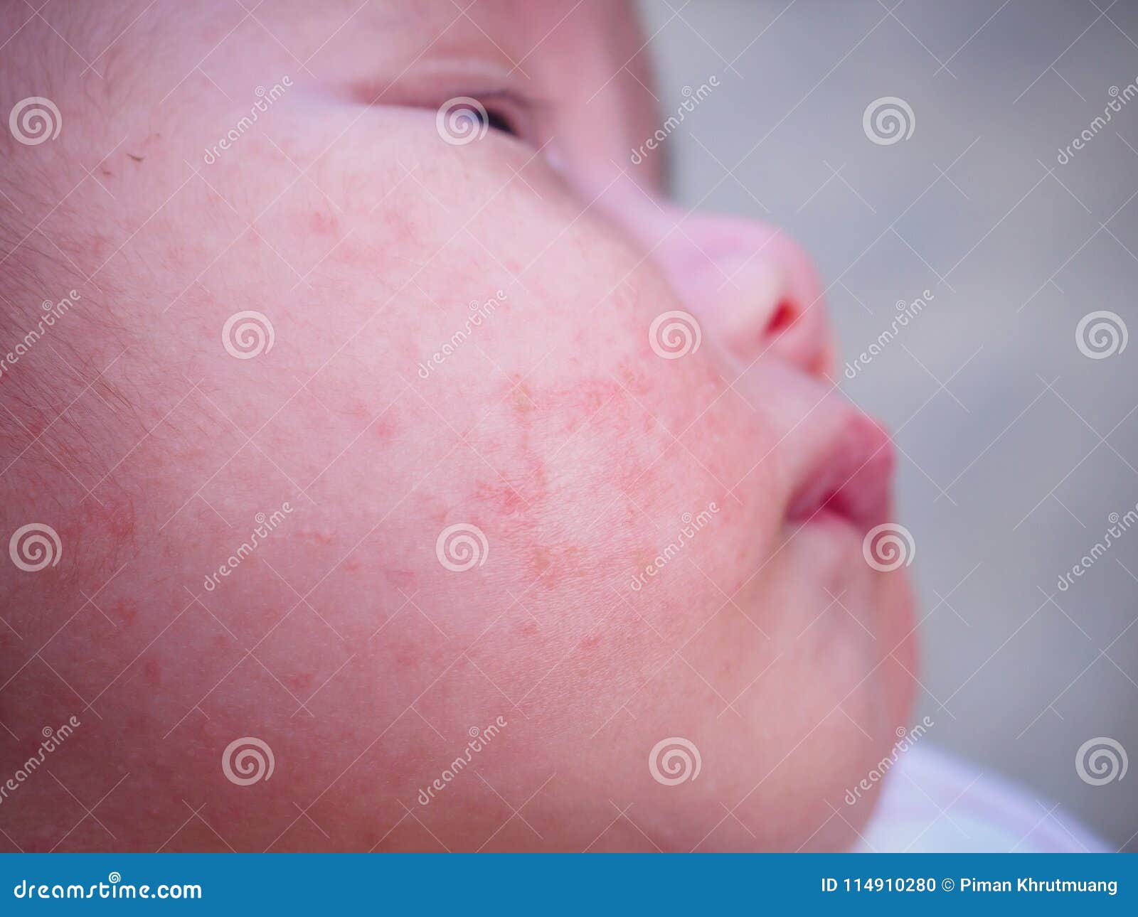Newborn Baby with Allergy on Face Stock Photo - Image of asian, atopic ...