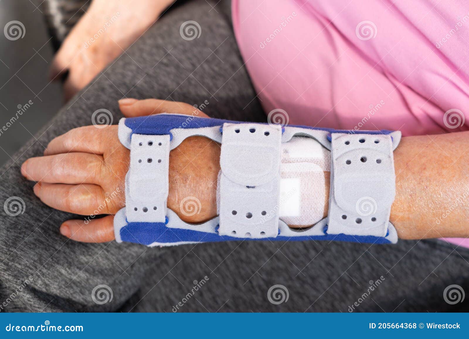 Newly Operated Broken Arm in a Splint Stock Photo - Image of people ...