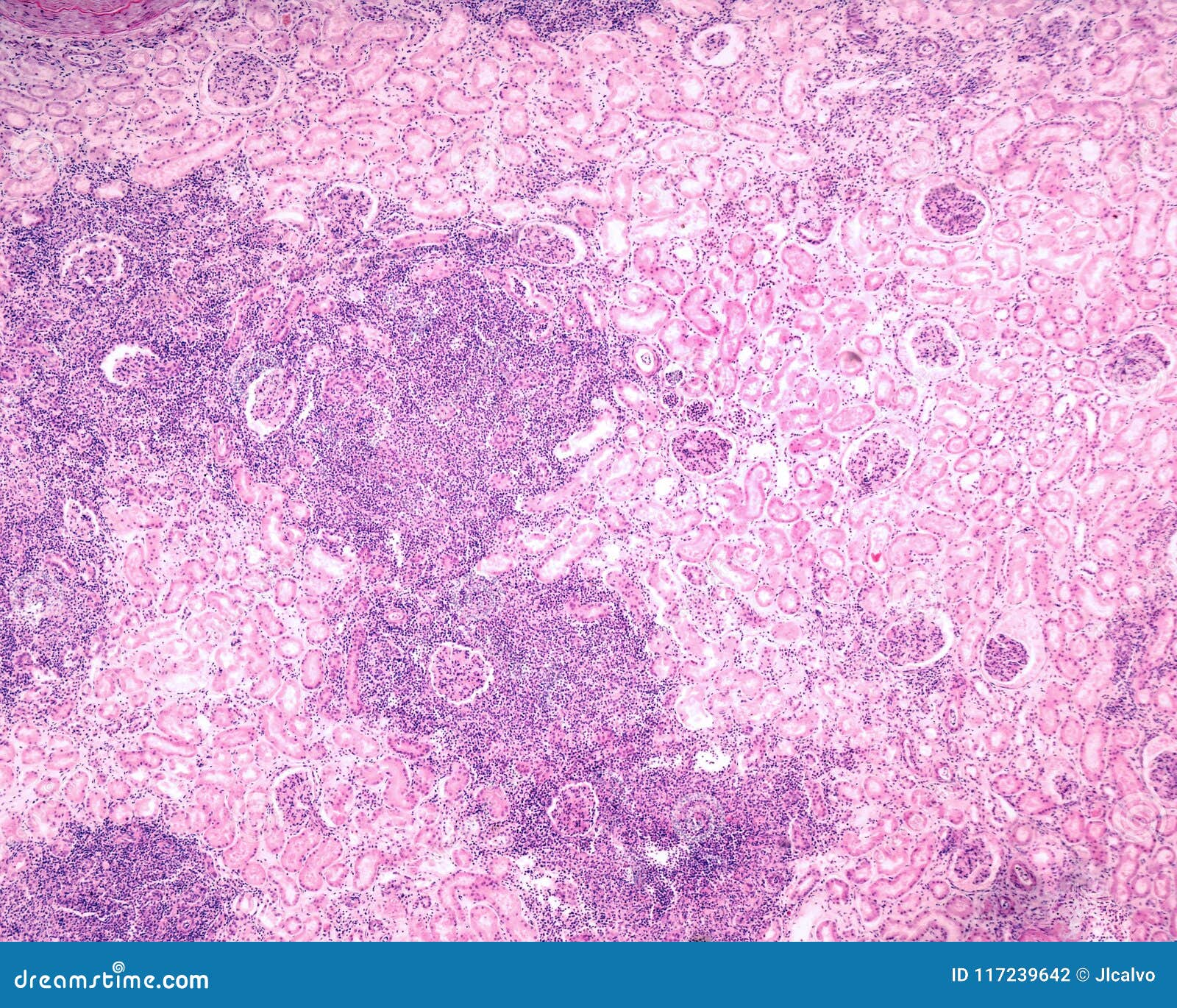 Nier Chronische Pyelonephritis Stock Foto - Image of schip, epitheliaal ...