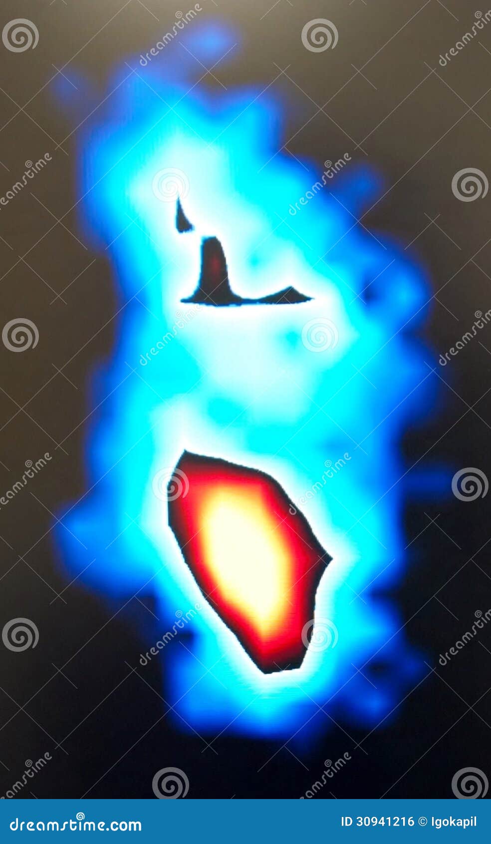 Nieren Kelche, Nuklearmedizin Stockfoto - Bild von arbeiten, pathologie ...