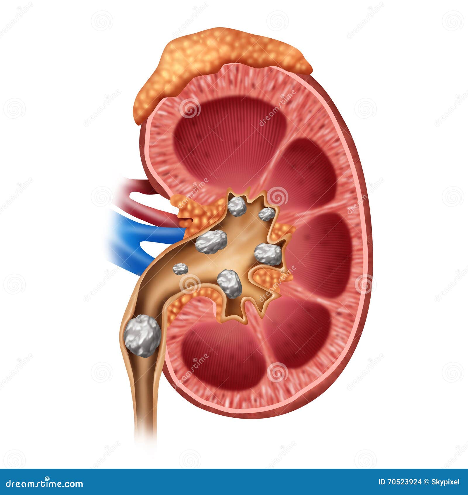 Nierensteine stock abbildung. Illustration von abbildung - 70523924