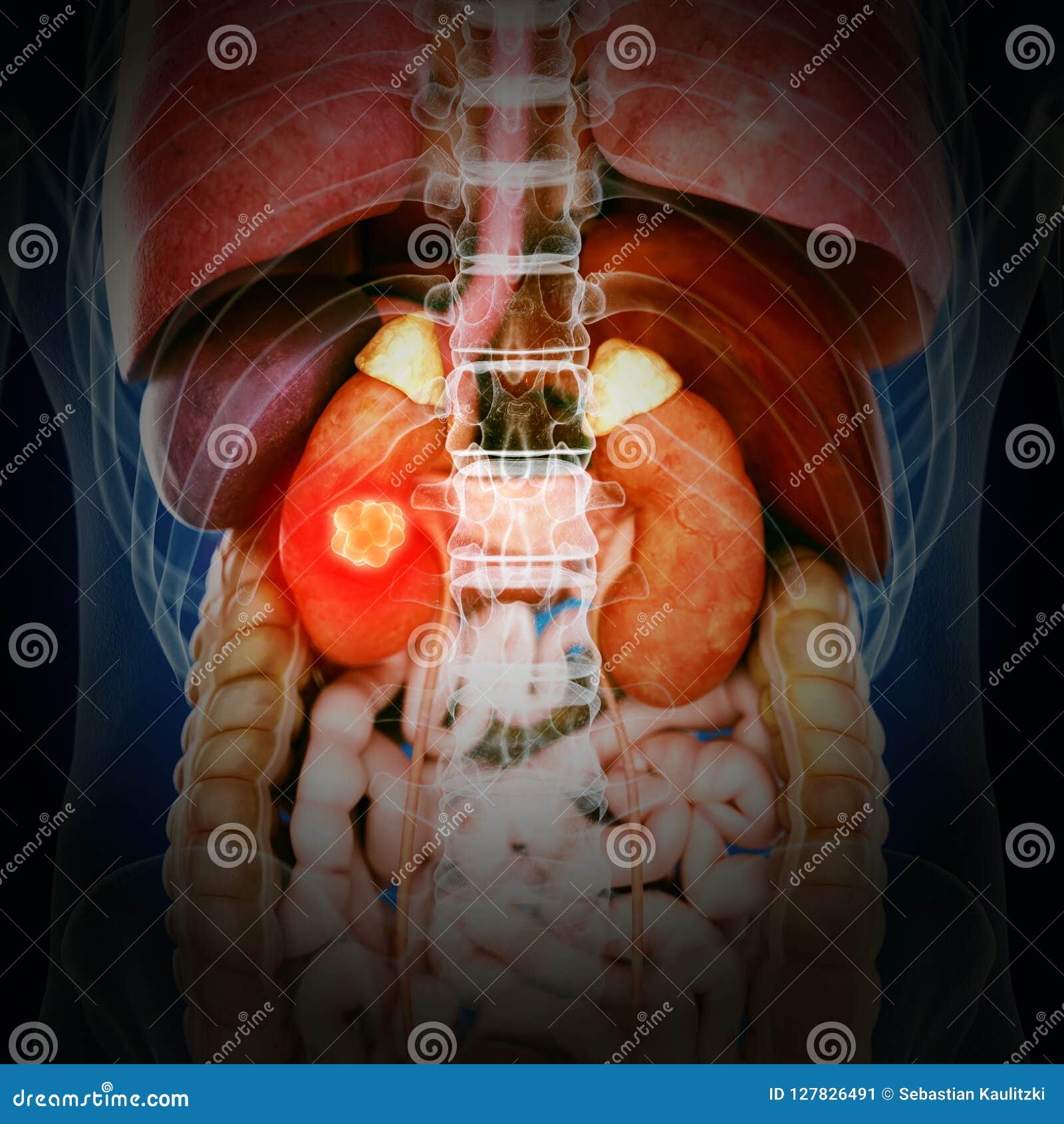 Nierkanker stock illustratie. Illustration of mannetje - 127826491
