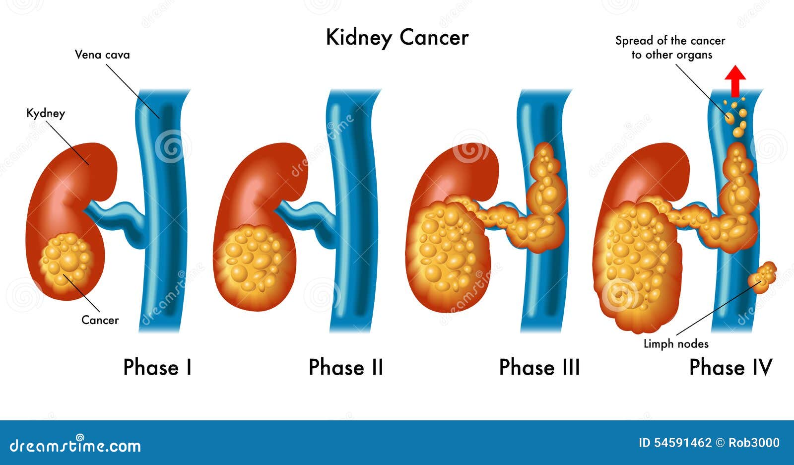 Nierkanker vector illustratie. Illustration of sarcoom - 54591462