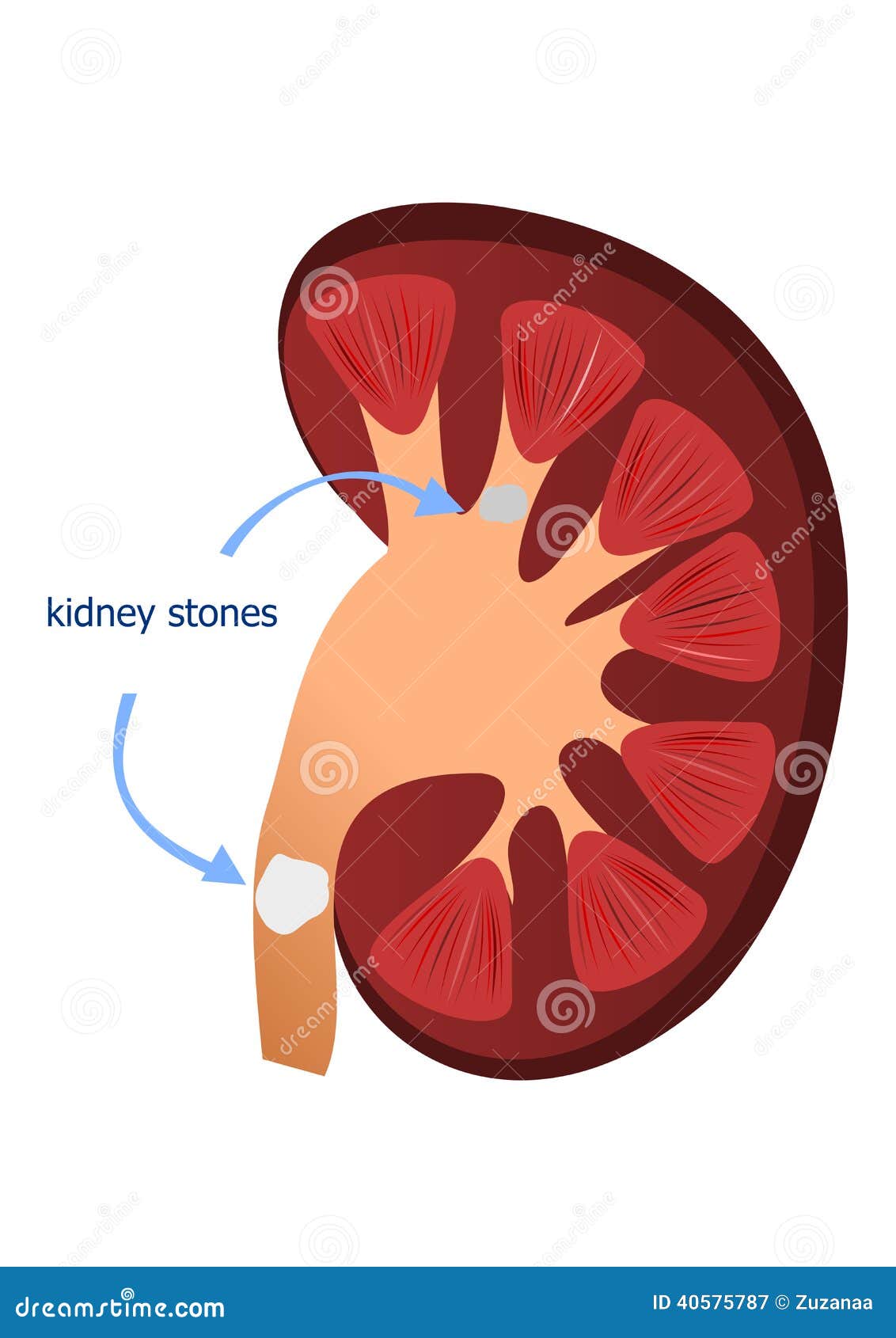 Nierstenen stock illustratie. Illustration of beschrijving - 40575787