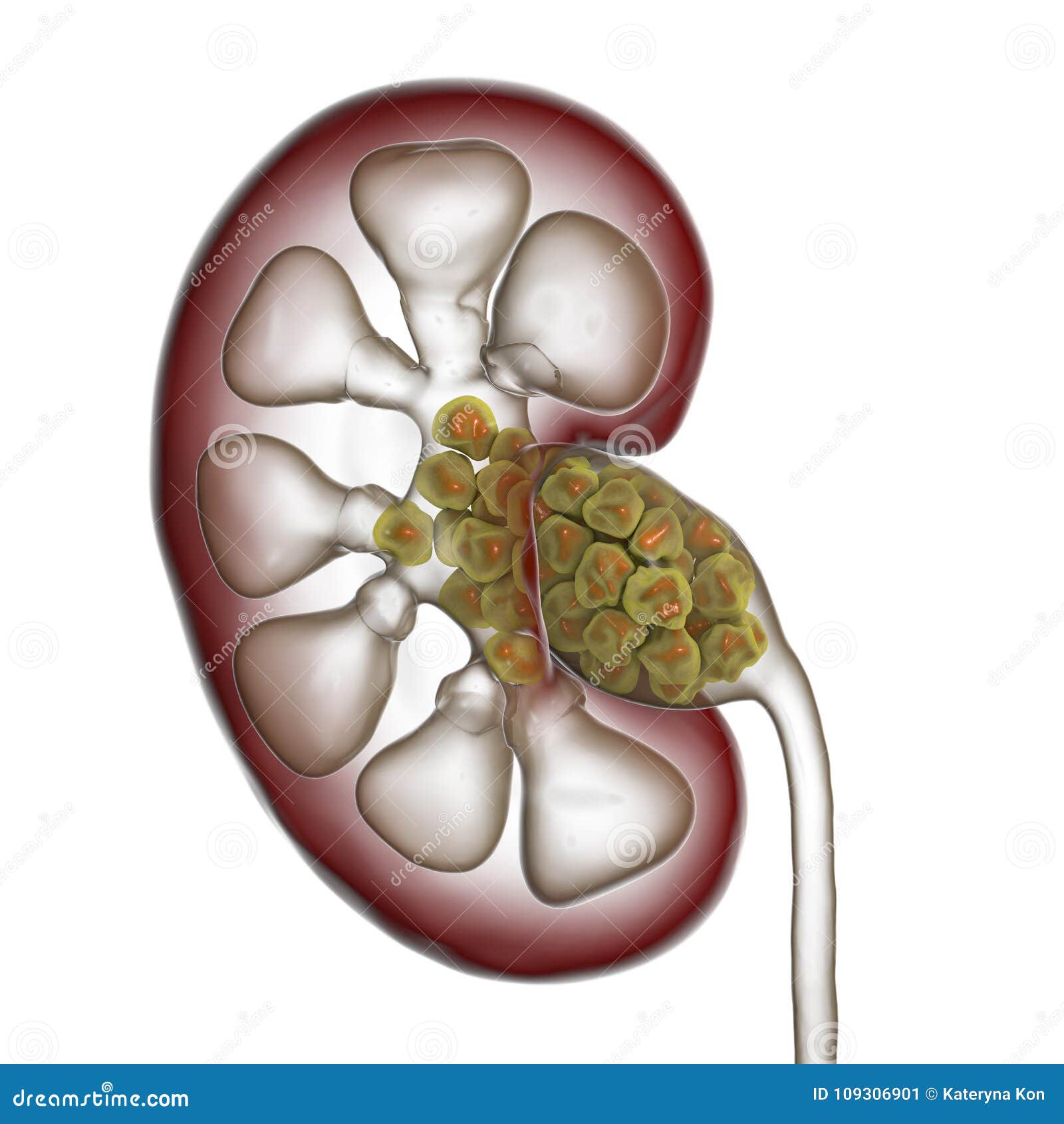 Nierstenen, Nephrolithiasis Stock Illustratie - Illustratie bestaande ...