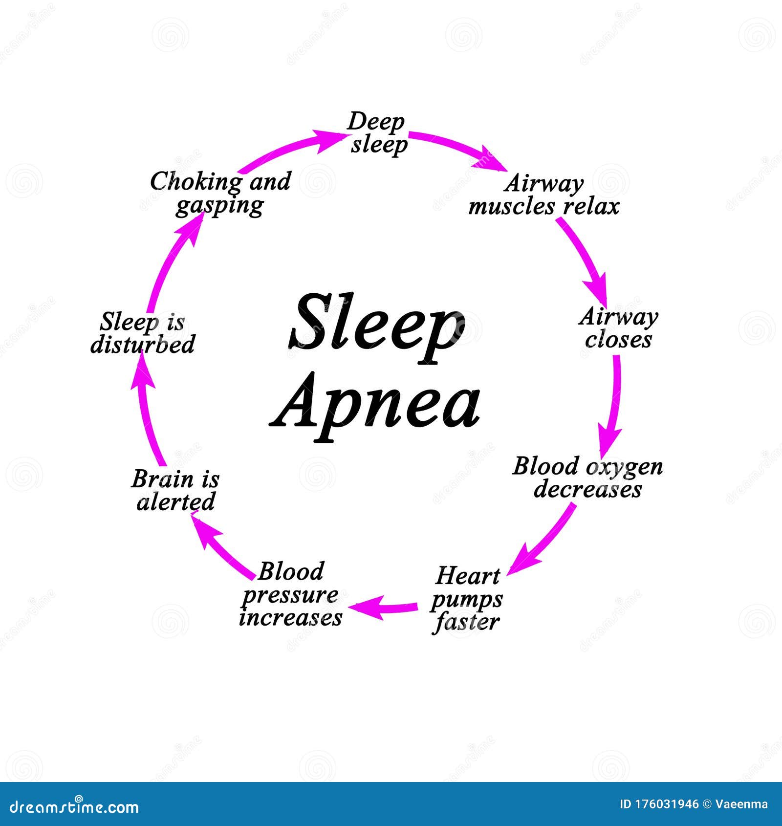 Sleep Apnea, CPAP Machine, Nasal Pillow Mask Cartoon Vector ...