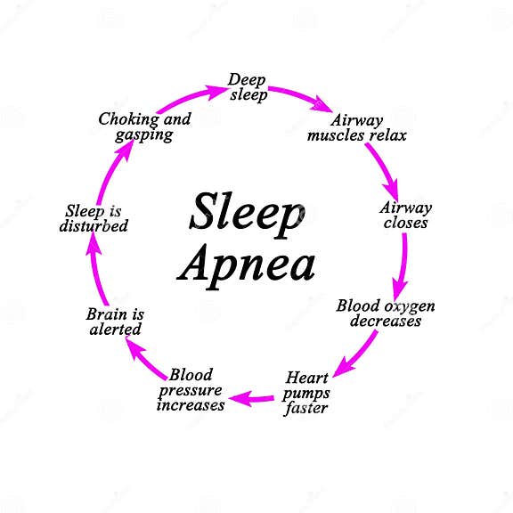 Development of Sleep Apnea stock illustration. Illustration of concept ...