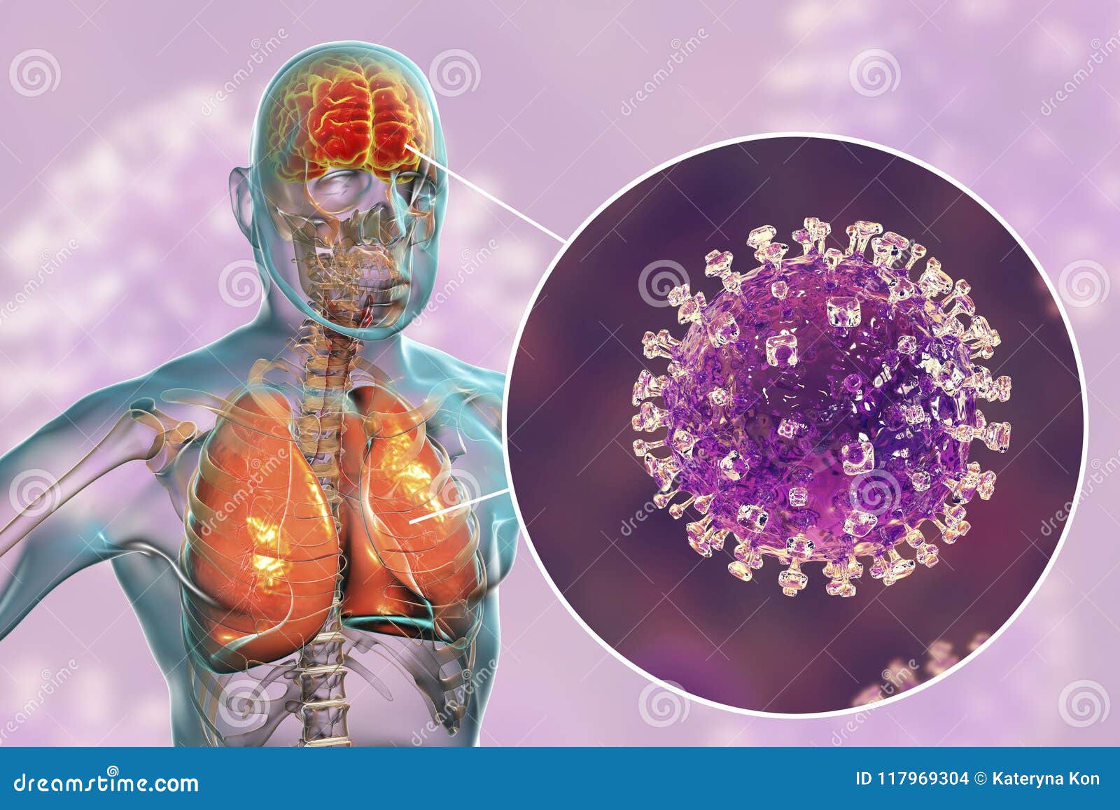 Nipah virusinfektion stock illustrationer. Illustration av svin - 117969304