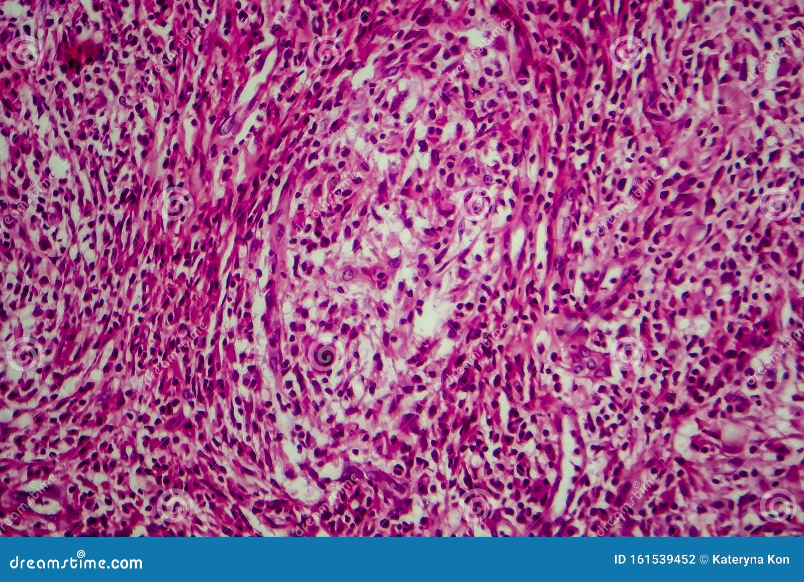 Non-Hodgkin`s Lymphoma, Light Micrograph Stock Photo - Image of ...