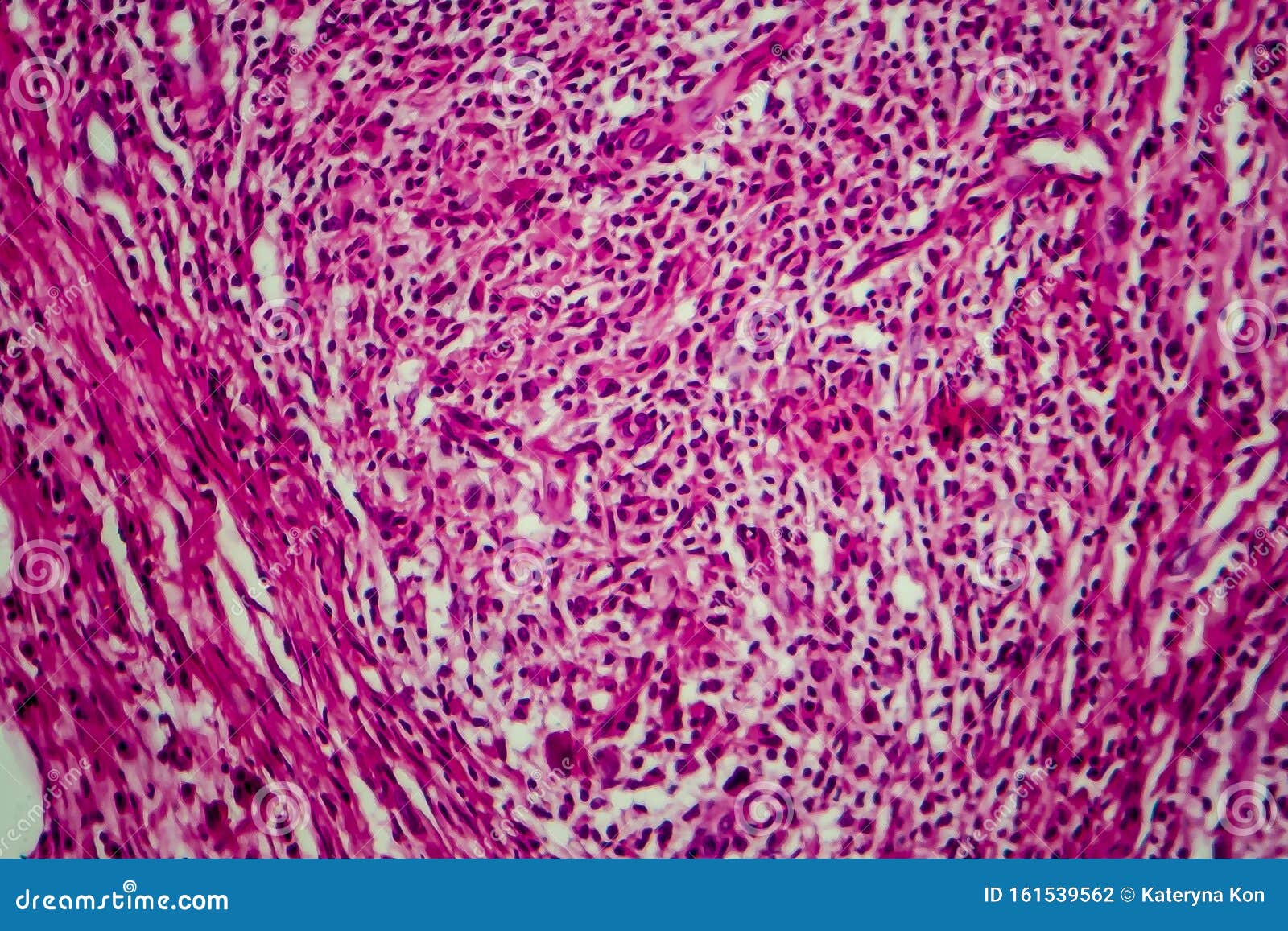 Non-Hodgkin`s Lymphoma, Light Micrograph Stock Photo - Image of ...